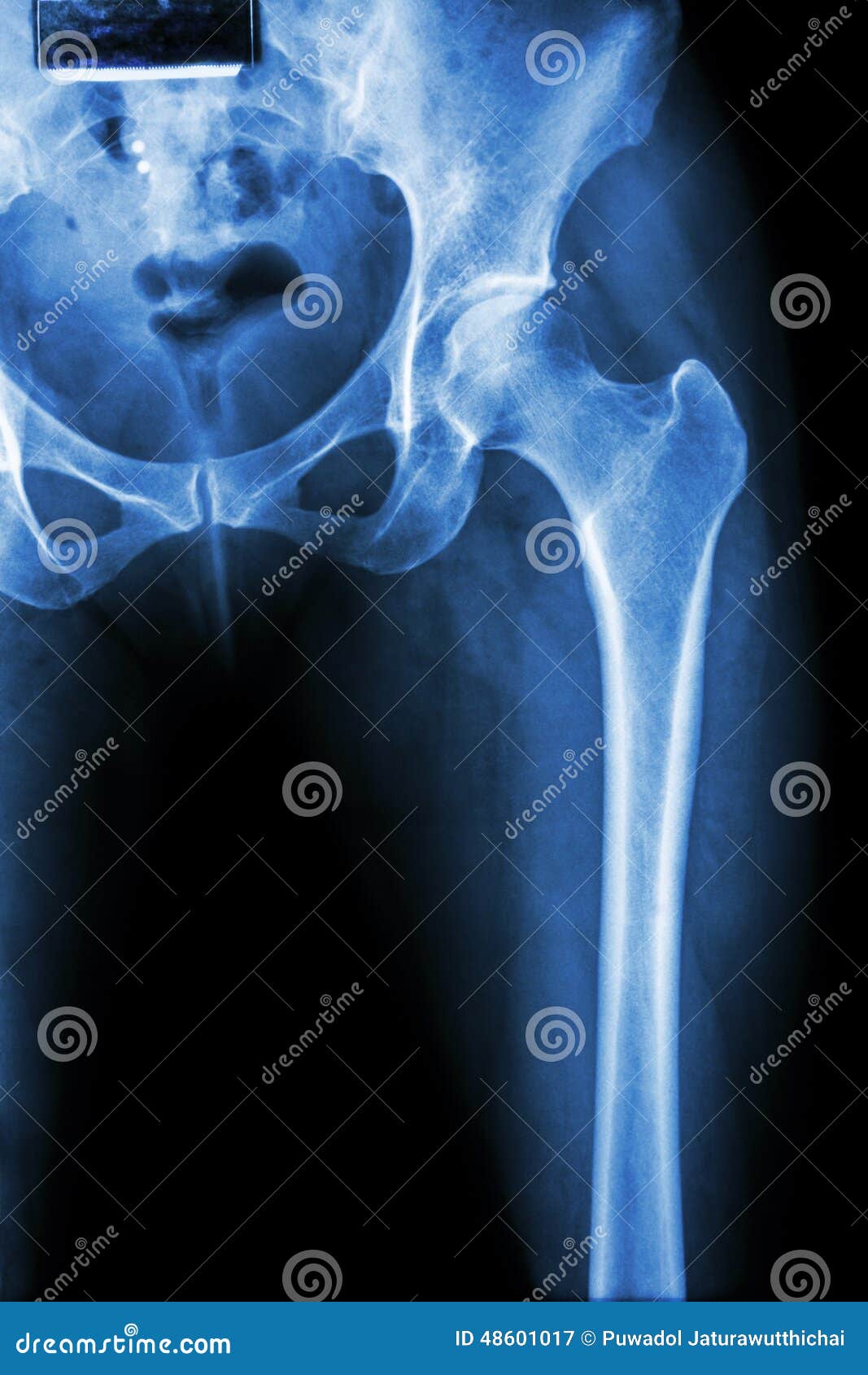 Normal Pelvis & Hip Joint Stock Image - Image of anatomy, buttock: 48601017