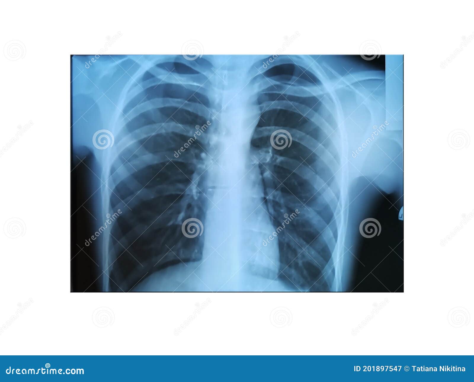 Plain Chest Radiograph Of Patient After Surgery Stock Photography ...