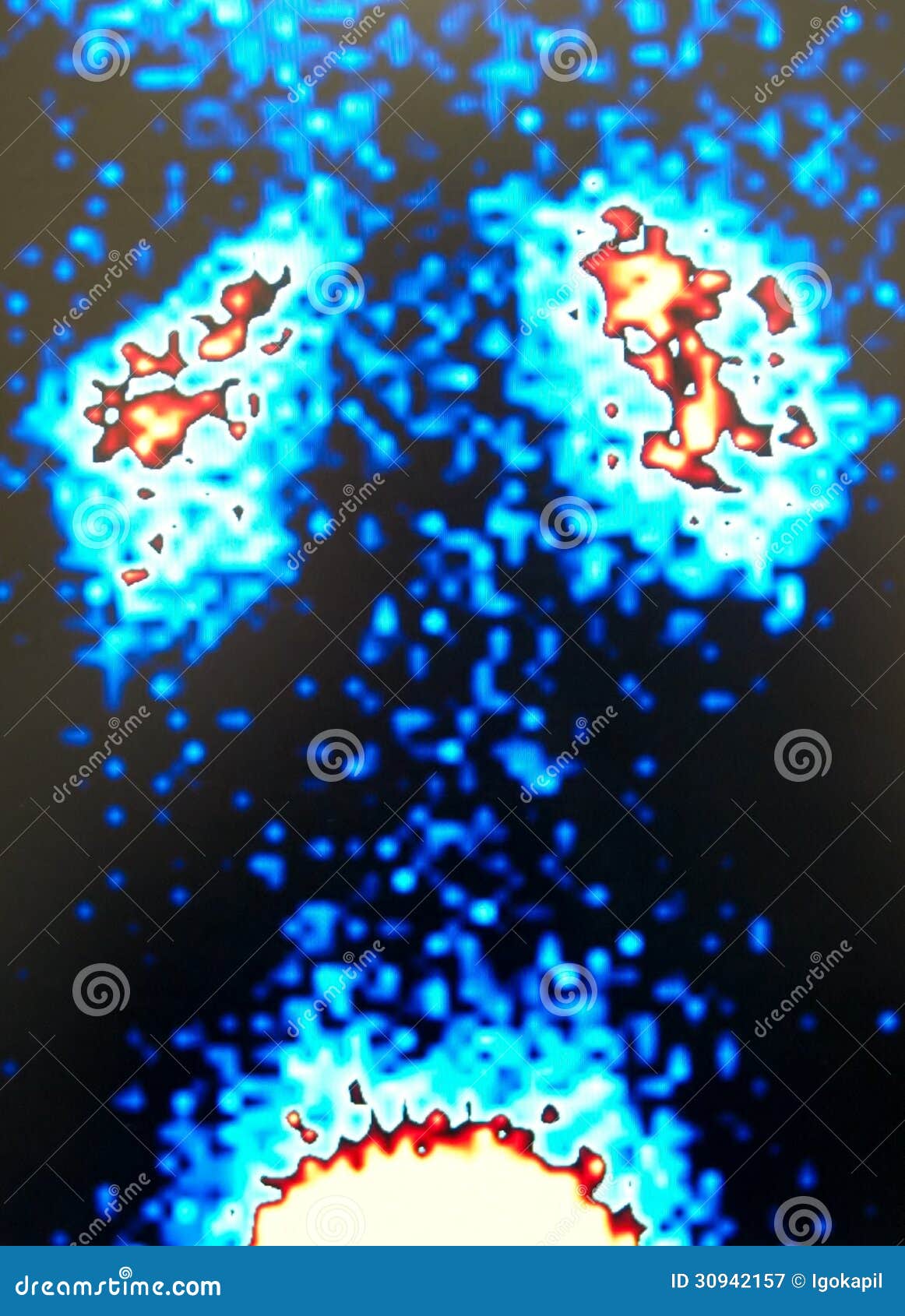 Normal Renal Flow,nuclear Medicine Stock Image - Image of blue, chronic ...