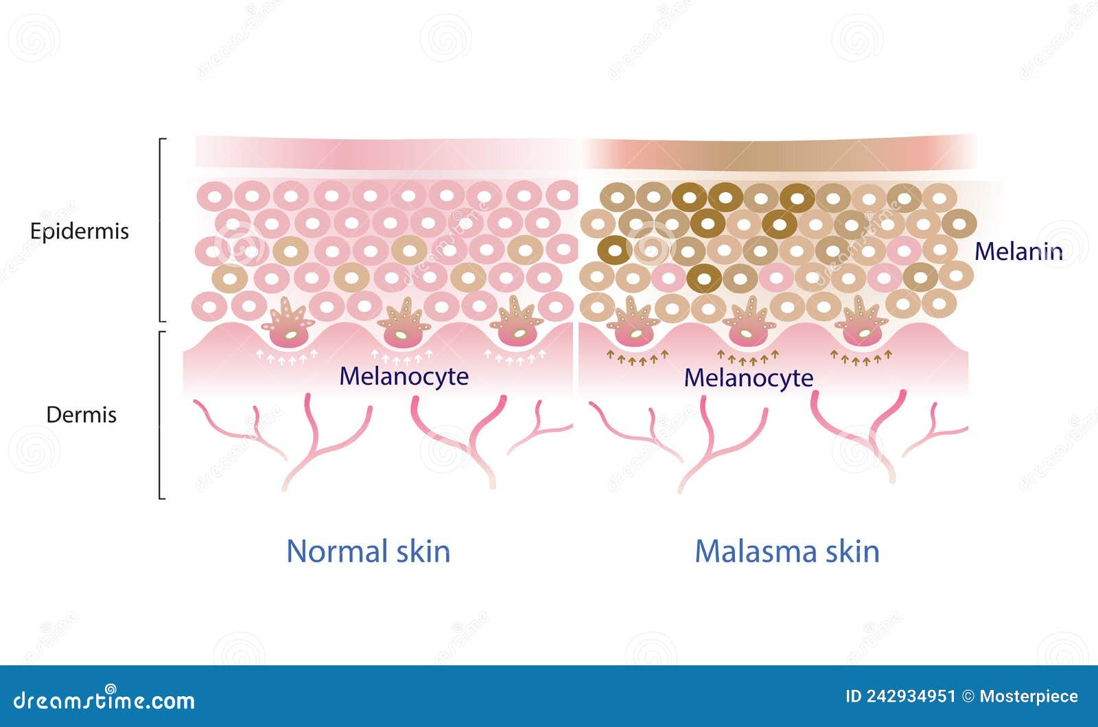 Normal Skin Layer and Melasma Skin Layer Vector. Stock Vector ...
