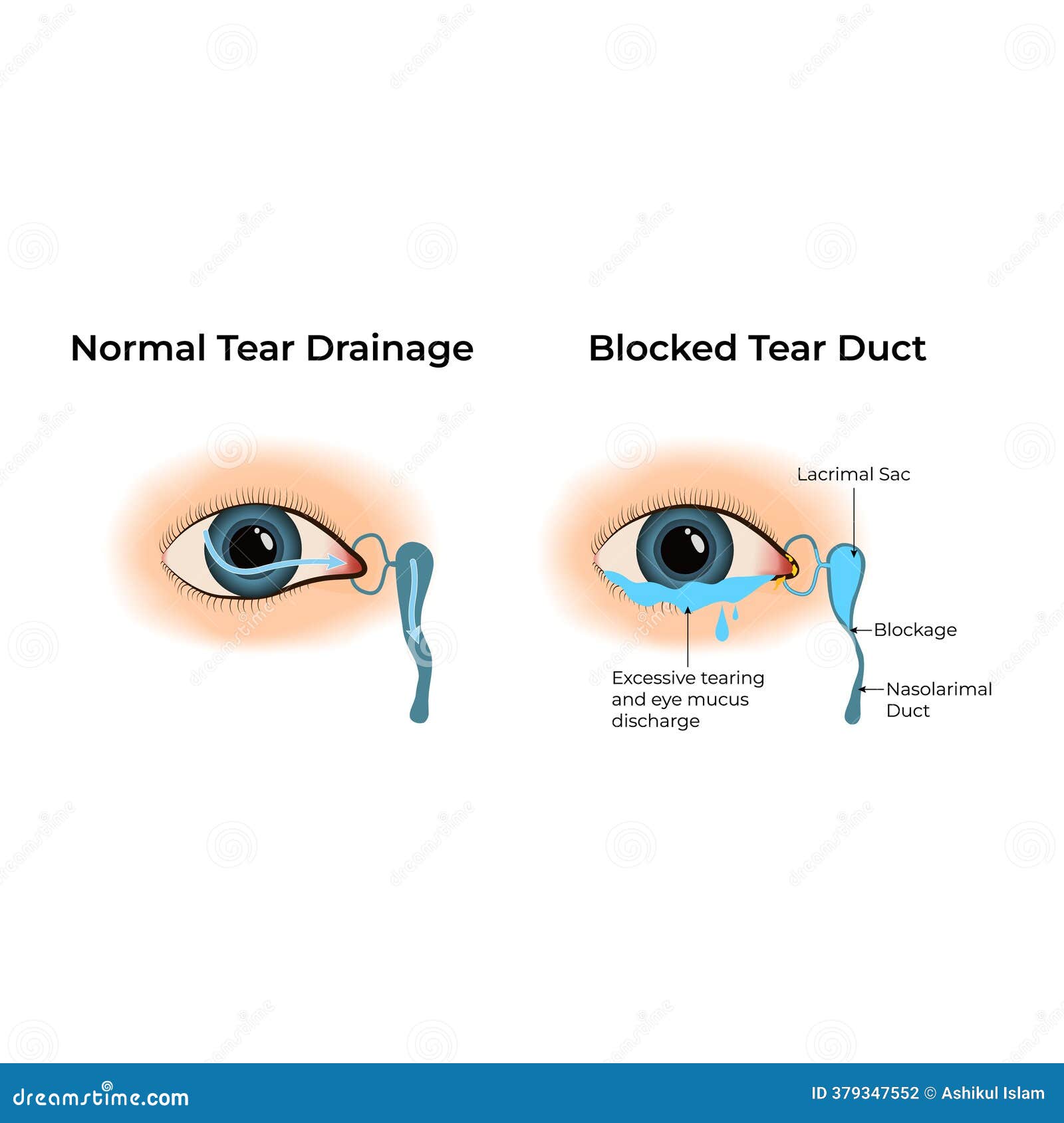 Blocked Tear Duct Diagram Medical Science Vector Illustration ...