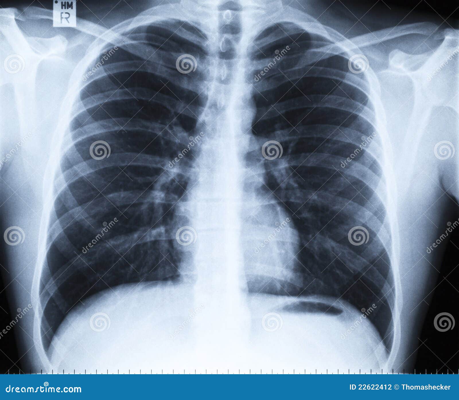 Normal Thoracic X-ray Image without Any Findings Stock Photo - Image of ...