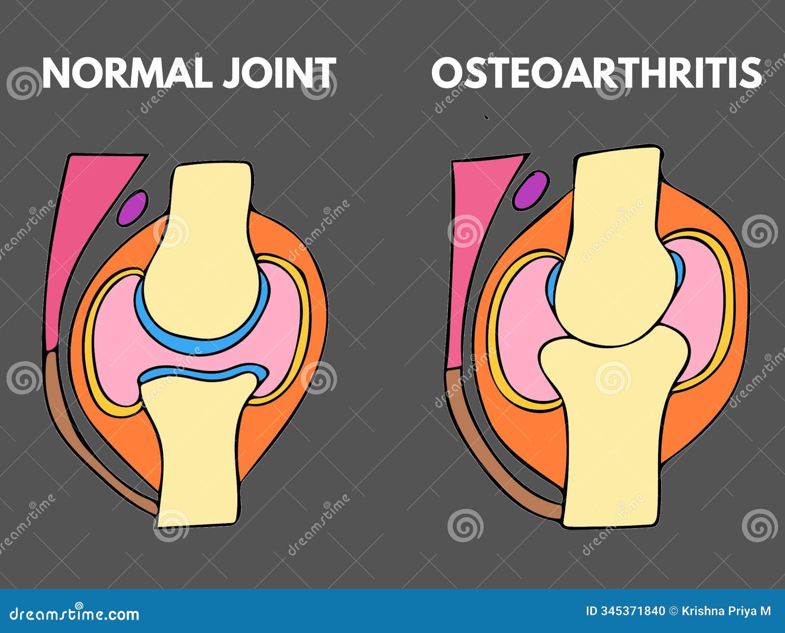 NORMAL VERSUS OSTEOARTHRITIS Joints Illustration Science Stock ...