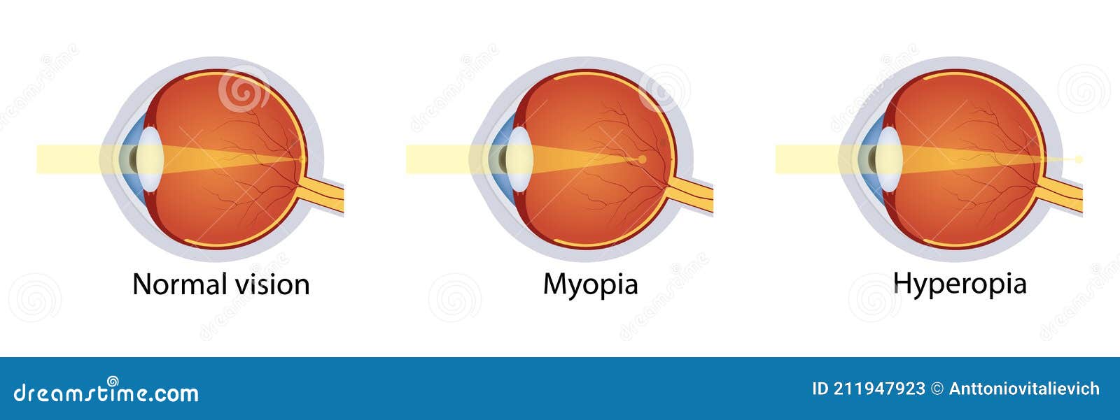 Normal Vision, Hyperopia, Myopia. Set of Vision Disorders. Anatomy of ...