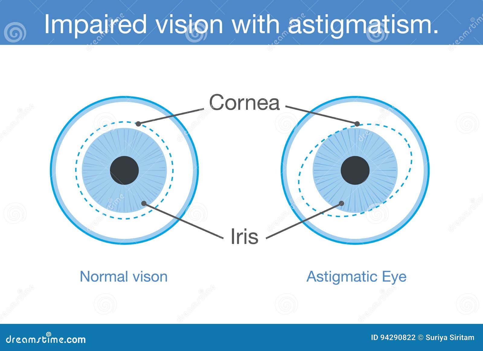 Eyeball Diagram Front