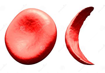 Normal Vs Sickle Red Blood Cell Stock Illustration - Illustration of ...