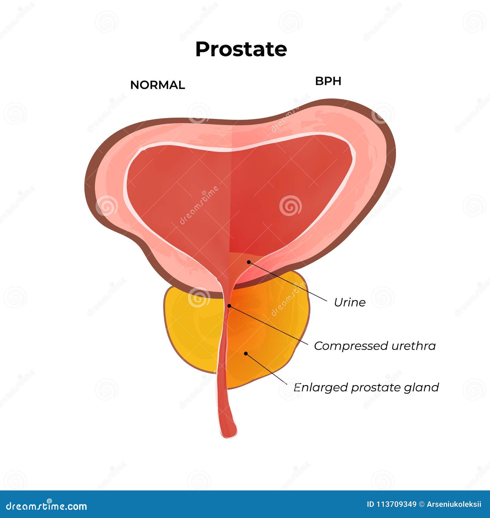 Normale En Ontstoken Prostaat Vector Illustratie - Illustration of ...