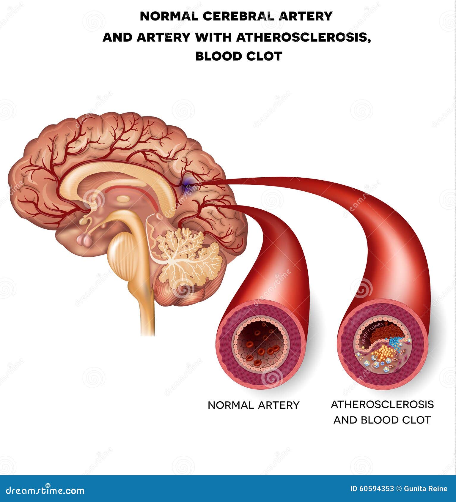 Normale Hersenslagader En Slagader Met Bloedstolsel Vector Illustratie ...