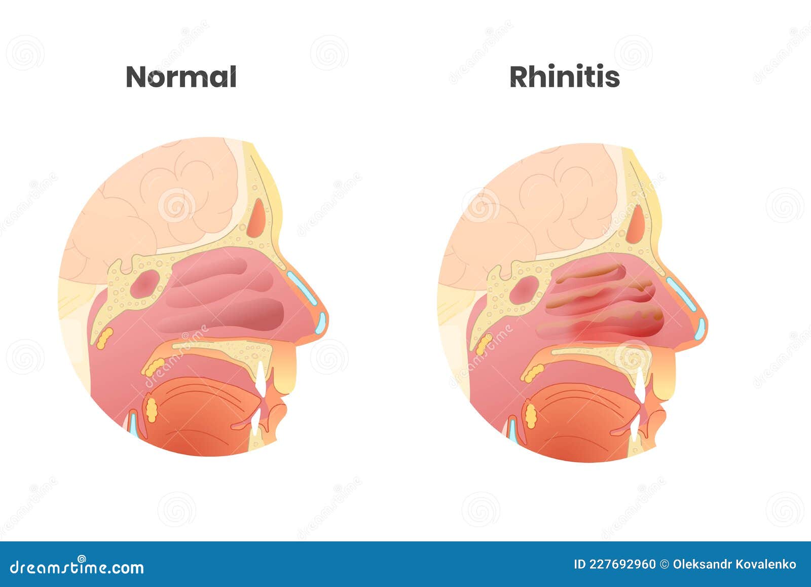 Normale Neusholte Versus Rhinitis Anatomie Illustratie Vector ...