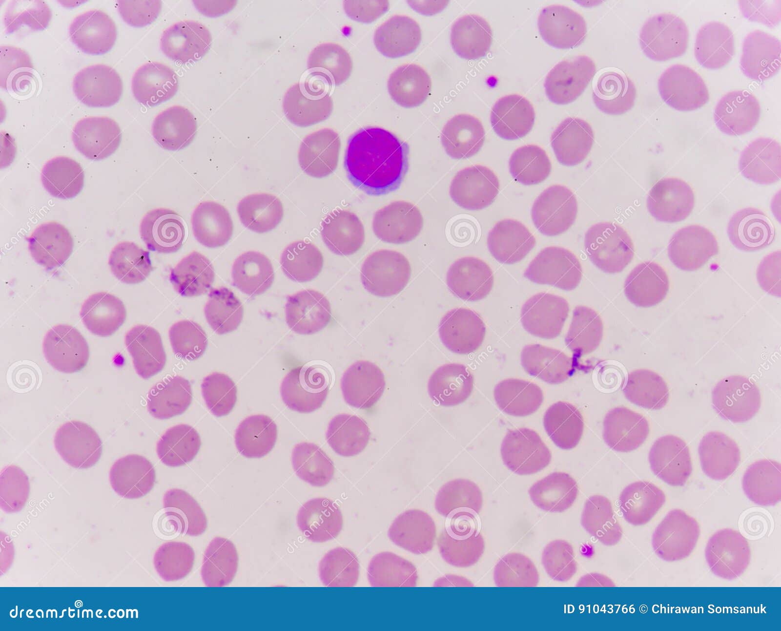 Normochromic Normacytic Red Blood Cells Stock Photo - Image of macro ...