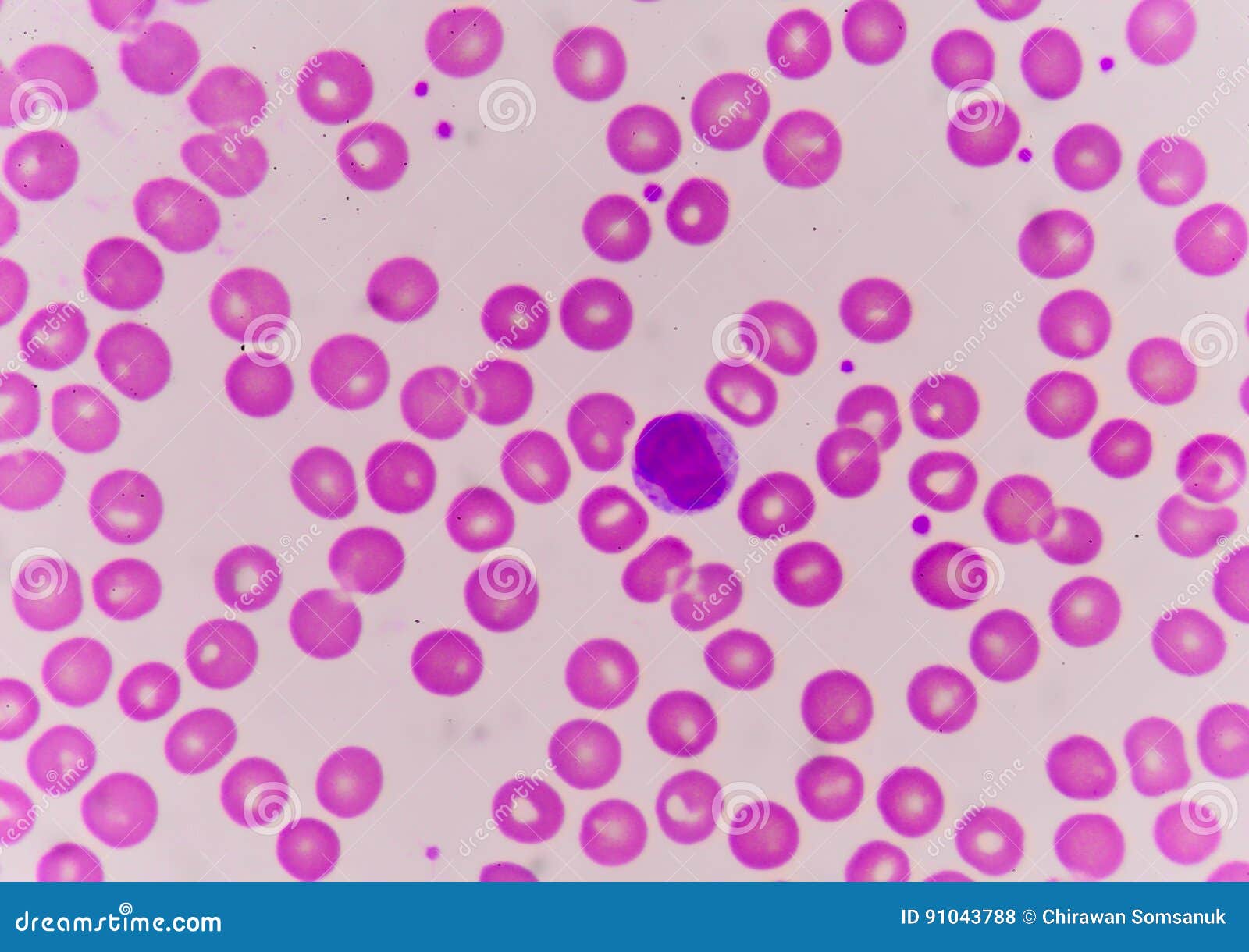 Normochromic Normacytic Red Blood Cells Stock Photo - Image of ...
