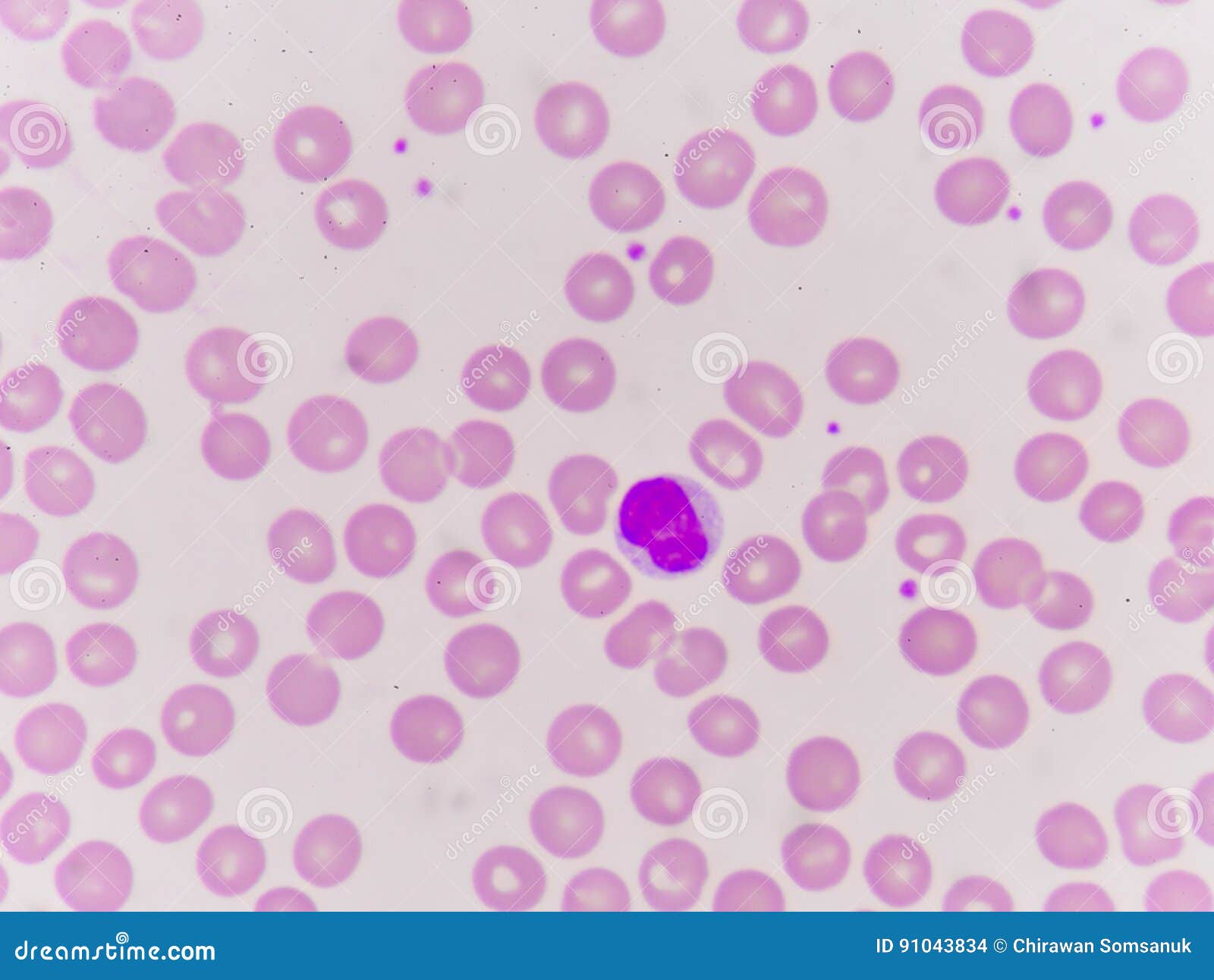Normochromic Normacytic Red Blood Cells Stock Photo - Image of ...