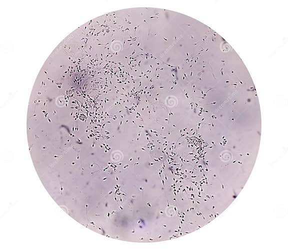 Normozoospermia Analyzed by Microscope. Stock Image - Image of semen ...