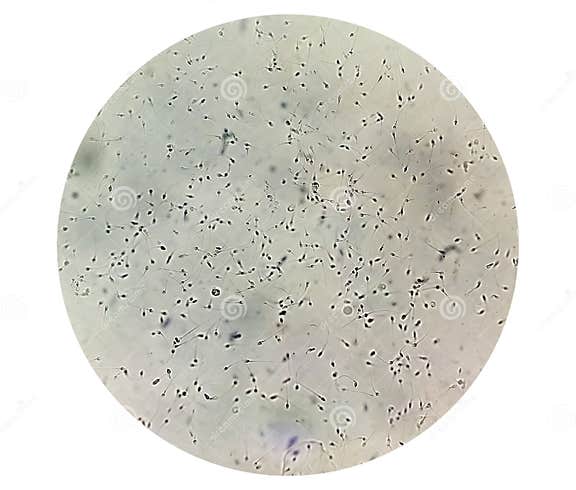 Normozoospermia Analyzed by Microscope Stock Photo - Image of observed ...