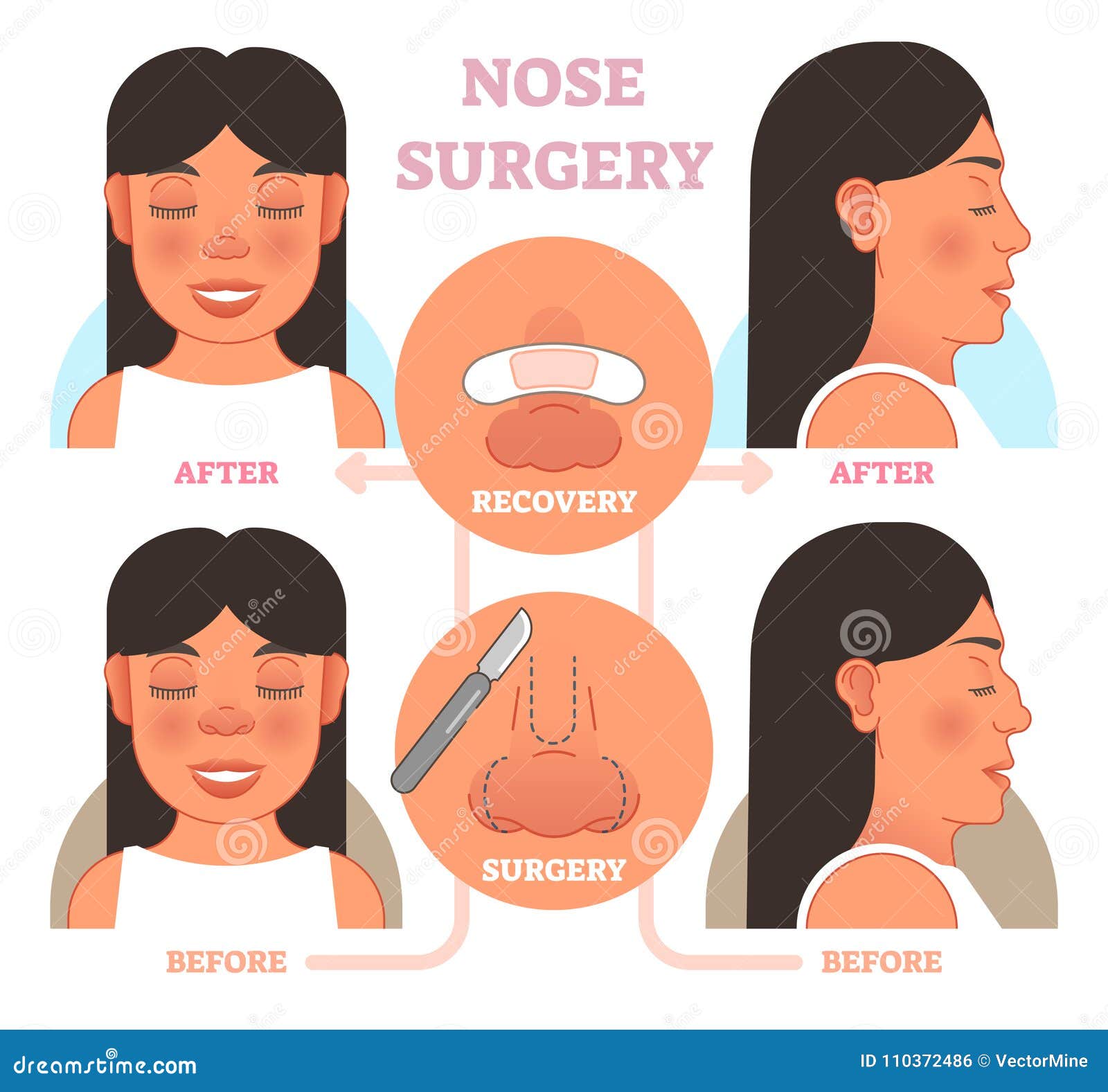 Nose Plastic Surgery Vector Illustration. Stock Vector - Illustration ...