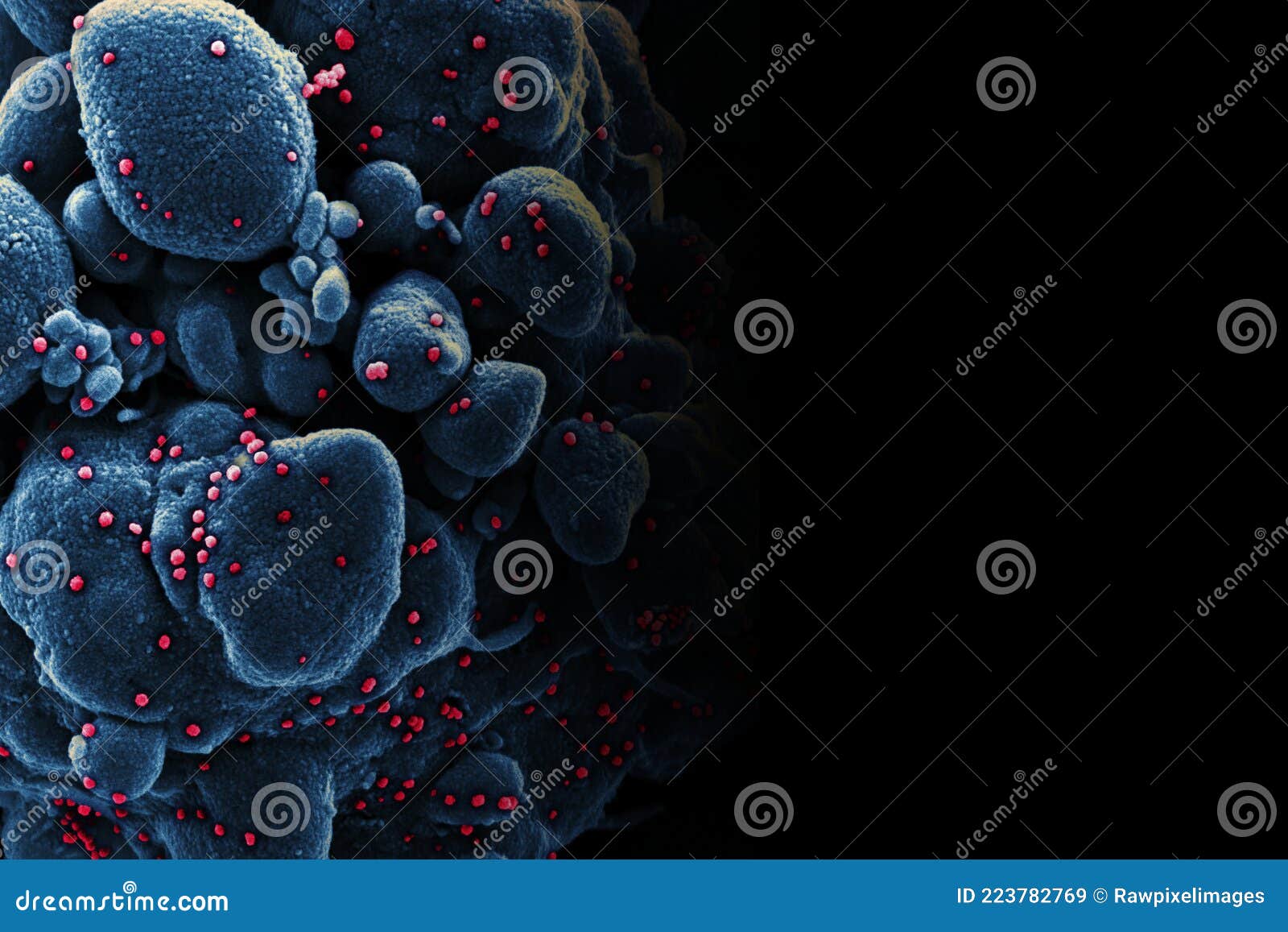 Electron Micrograph Of Pseudomonas Aeruginosa Infection In Wound ...