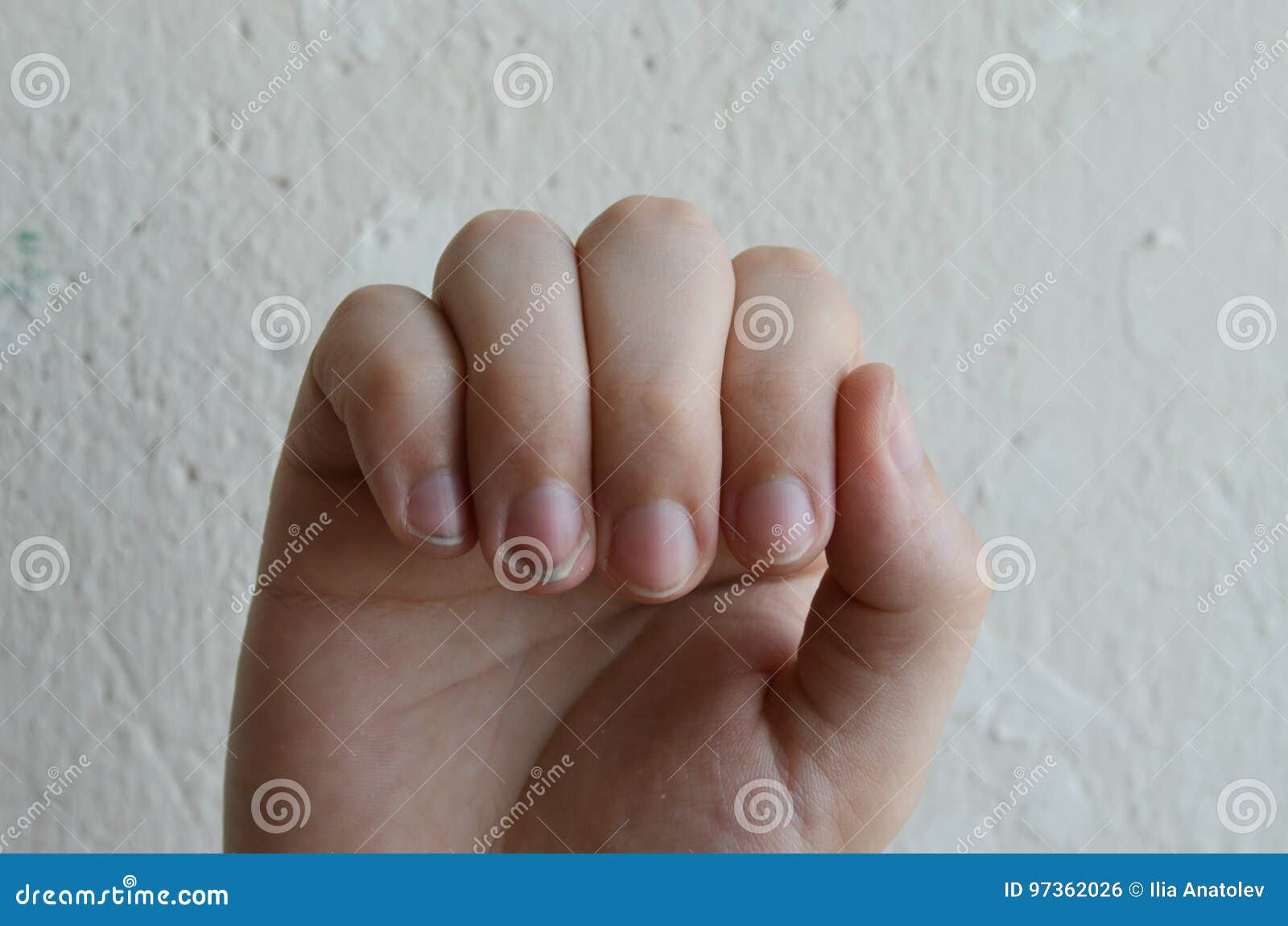 NPsoriasis on the Nails, Problems with the Nails Stock Photo - Image of ...