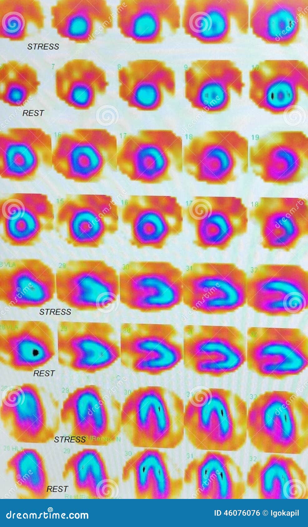 Nuclear Myocardial Perfusion Stress Test Stock Photo - Image of ...