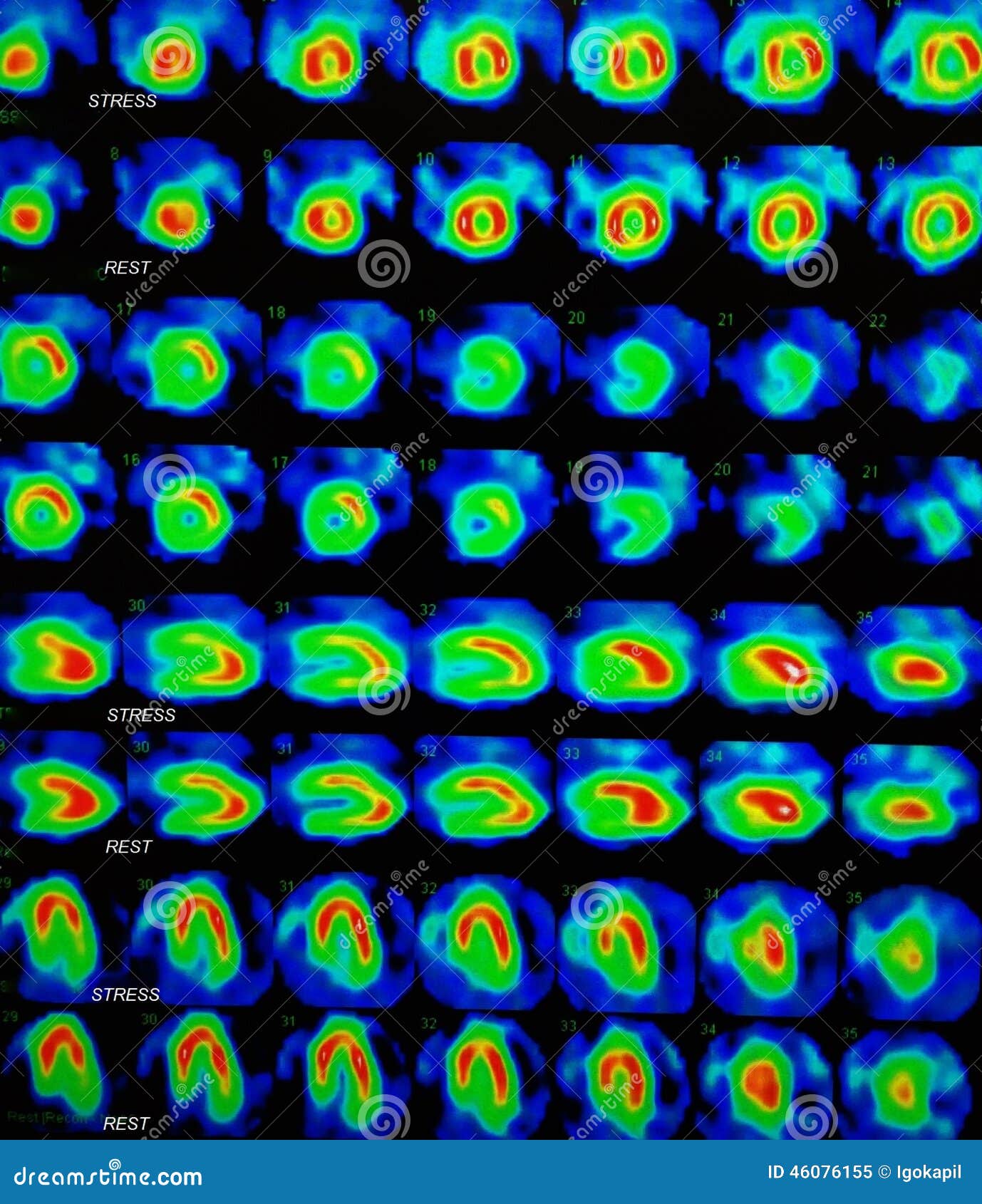Nuclear Myocardial Perfusion Stress Test Stock Image - Image of ...