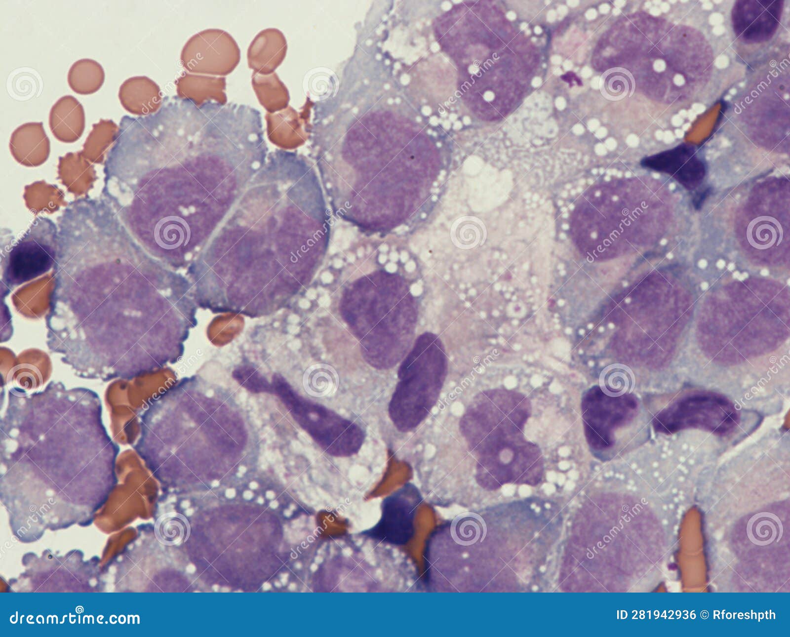 Acute Monocytic Leukemia in Pleural Fluid. Stock Photo - Image of ...