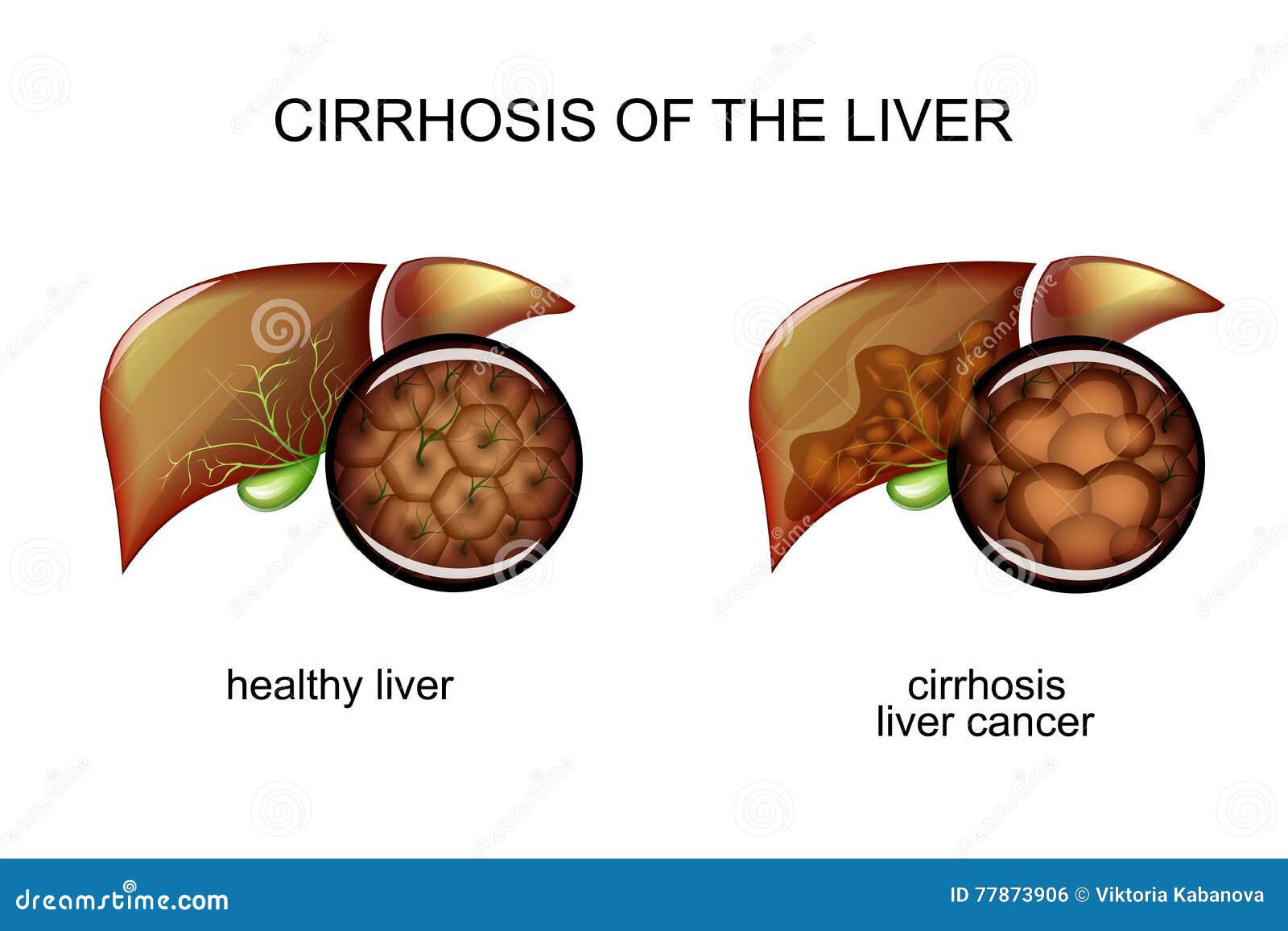 O Fígado Saudável E O Paciente Com Cirrose Ilustração do Vetor ...