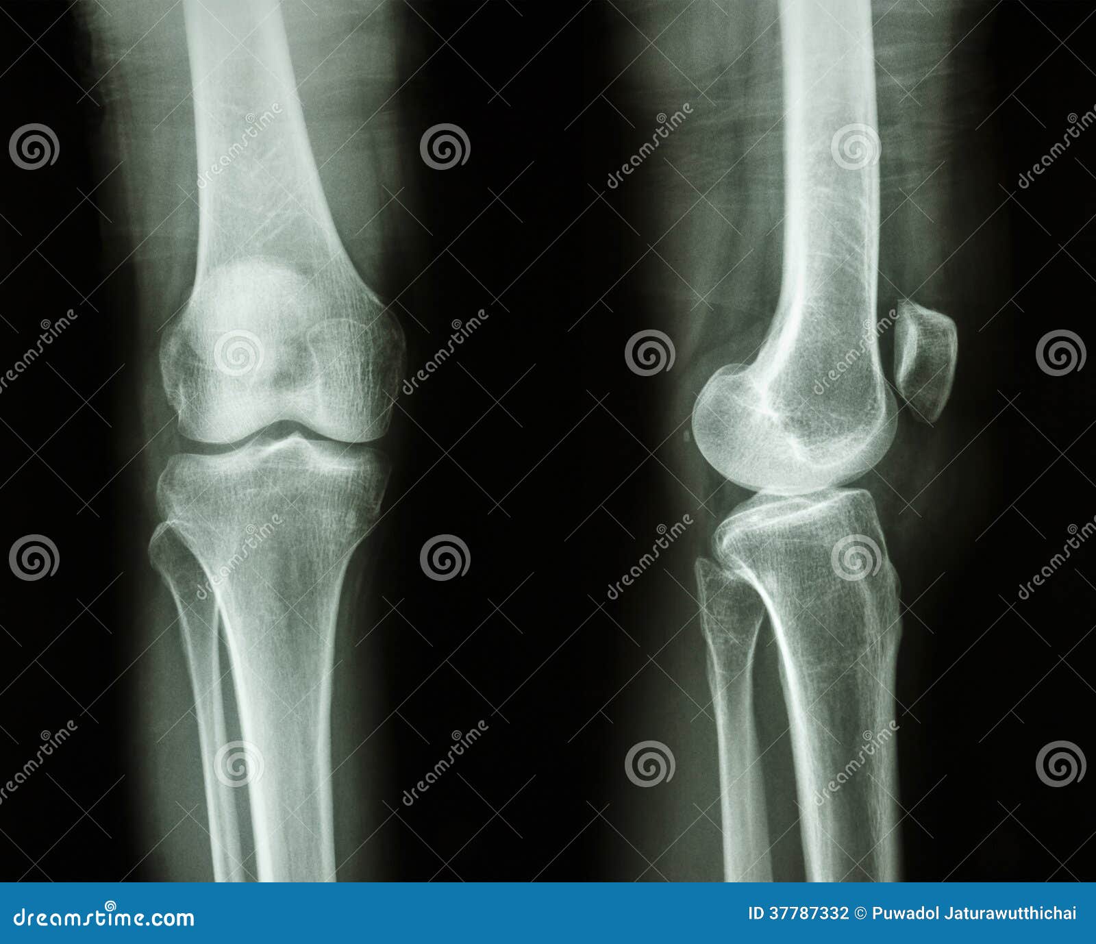 O Joelho Do Ser Humano Normal Foto de Stock - Imagem de povos, imagem ...