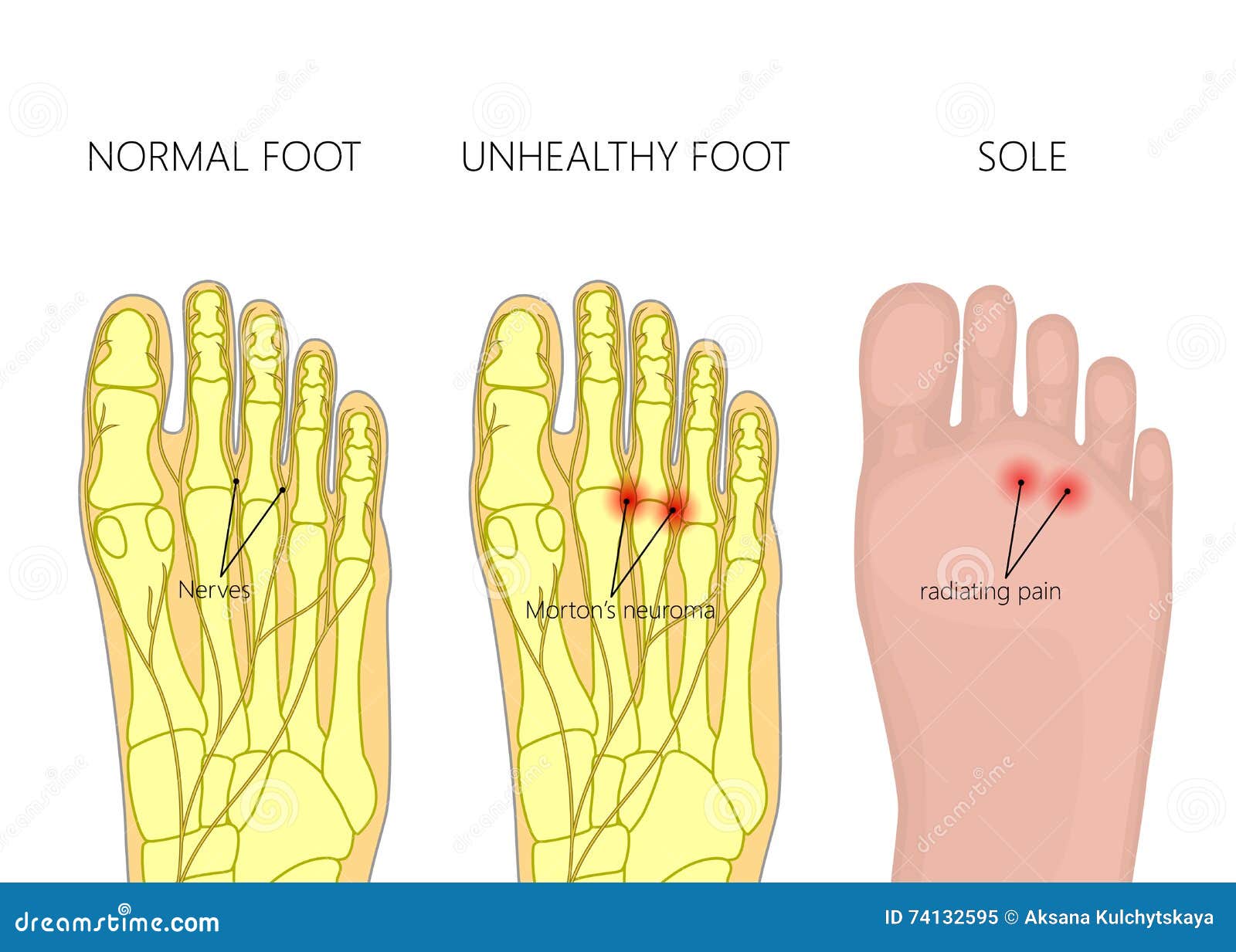 O neuroma de Morton ilustração do vetor. Ilustração de dano - 74132595
