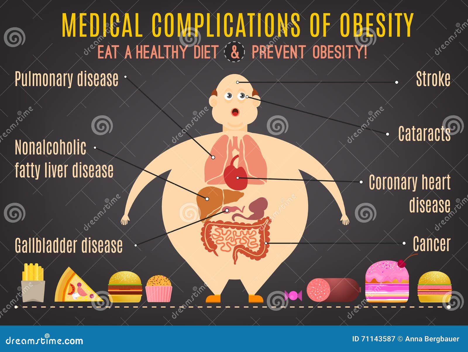 Obésité Infographics 1-09 illustration de vecteur. Illustration du ...