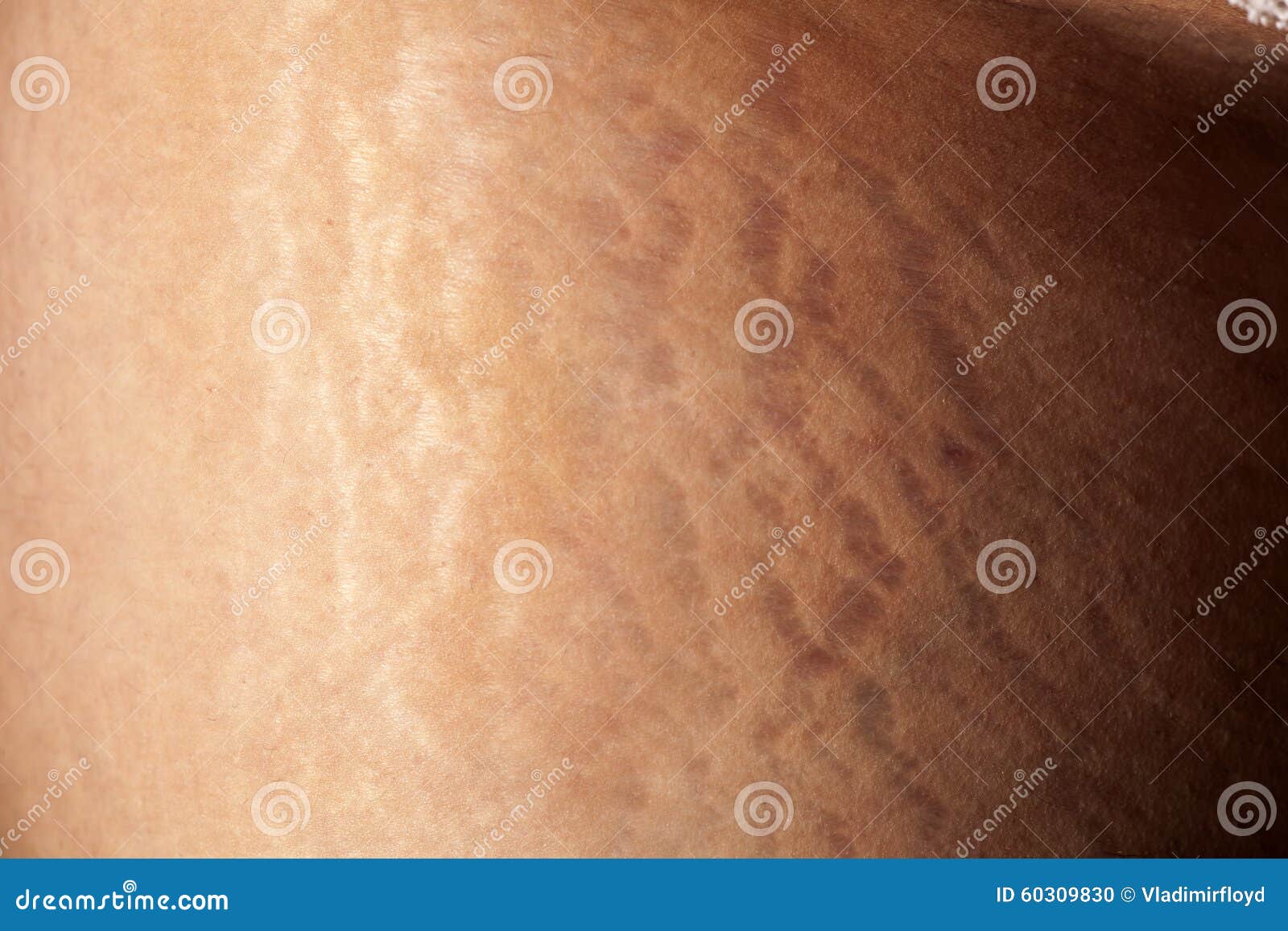 Obesity stock photo. Image of diet, obese, body, stretchmarks - 60309830