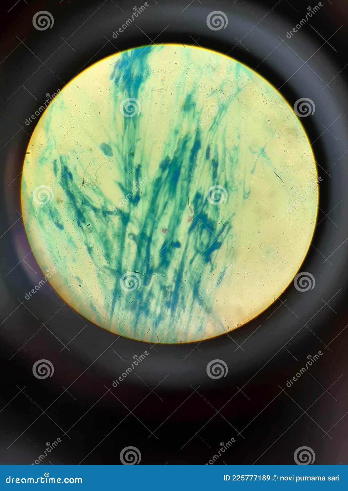 Observation of BTA & X28;acid-fast Bacteria& X29; Under a Microscope ...
