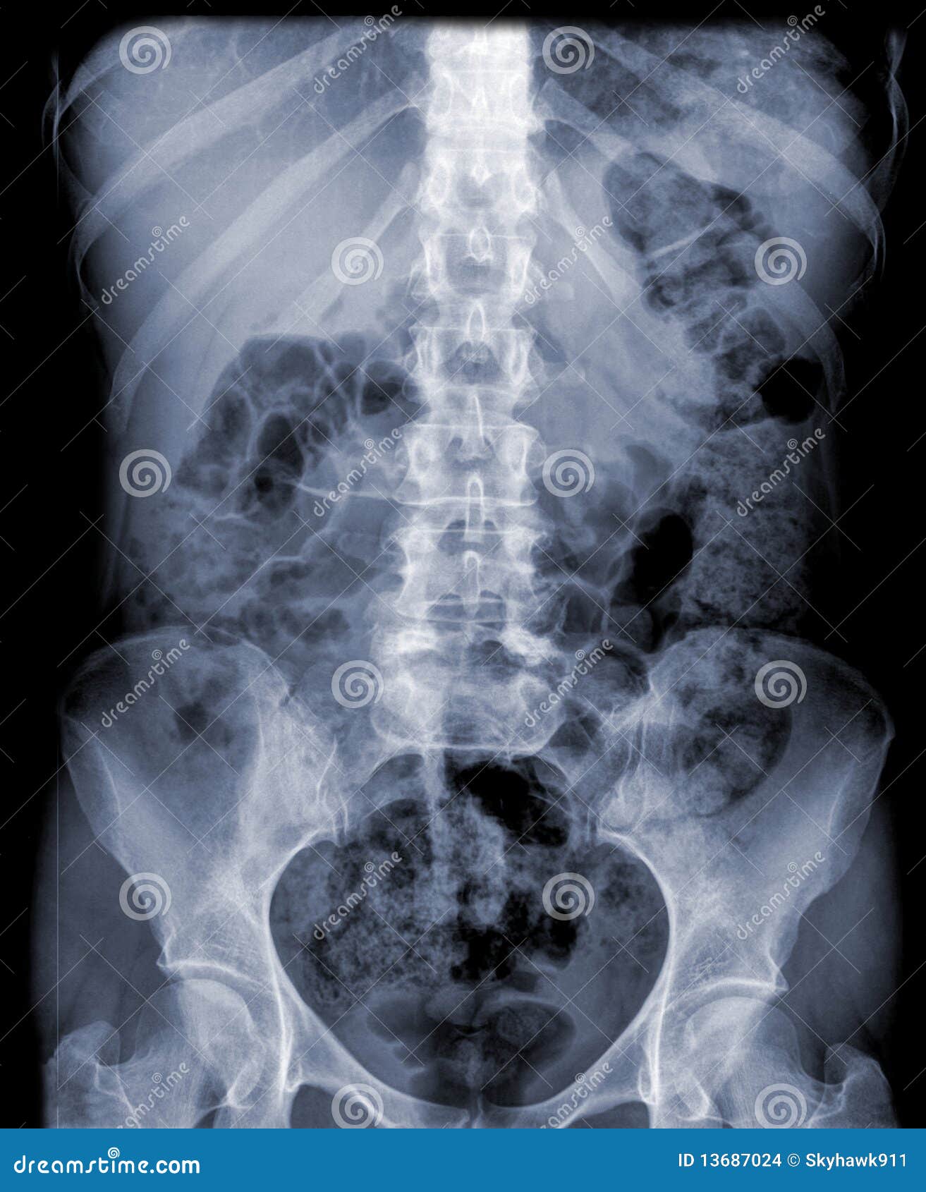 Obstipated stomache stock photo. Image of bone, radiography - 13687024