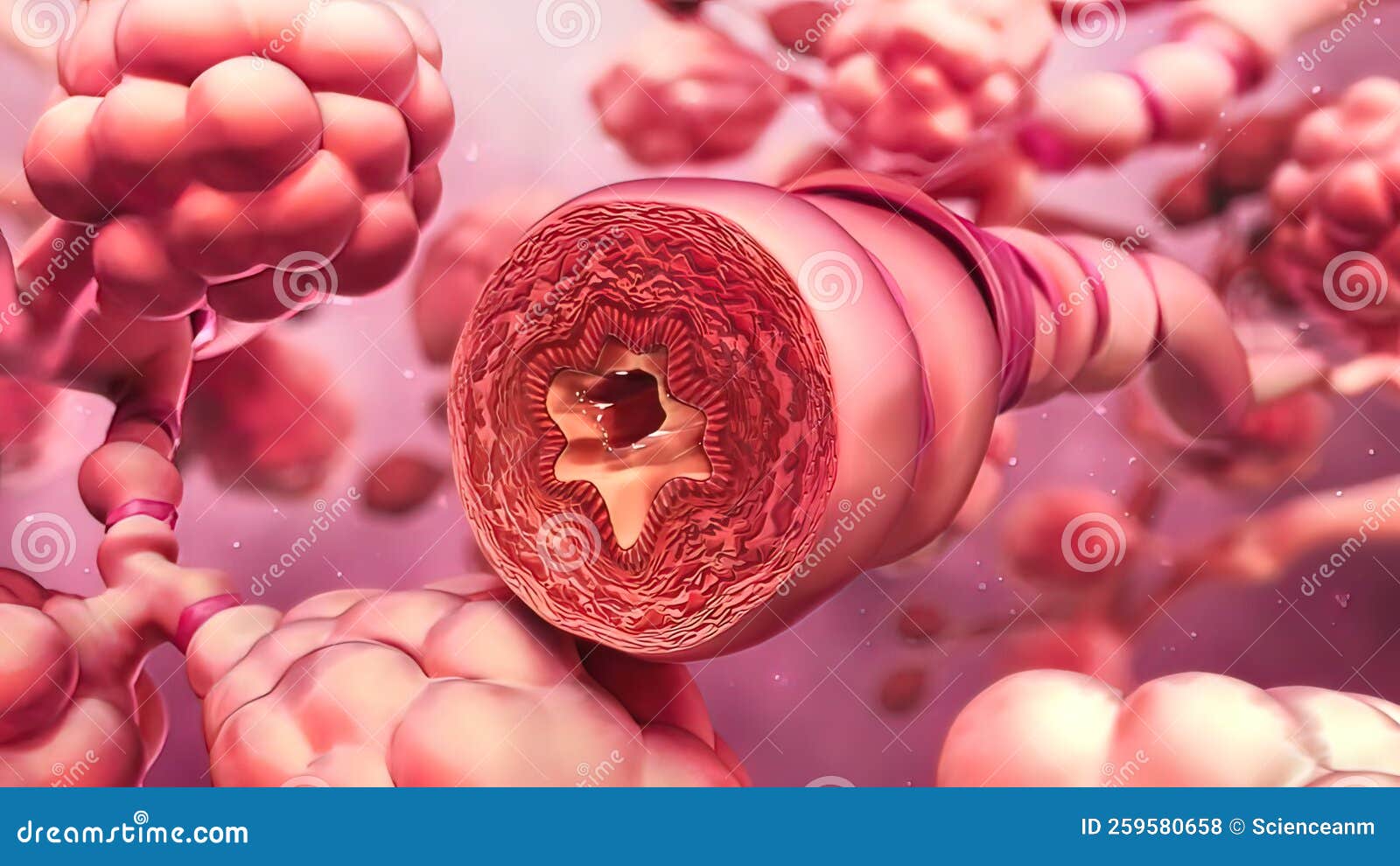 Obstruction of the Bronchi 3d Stock Illustration - Illustration of ...