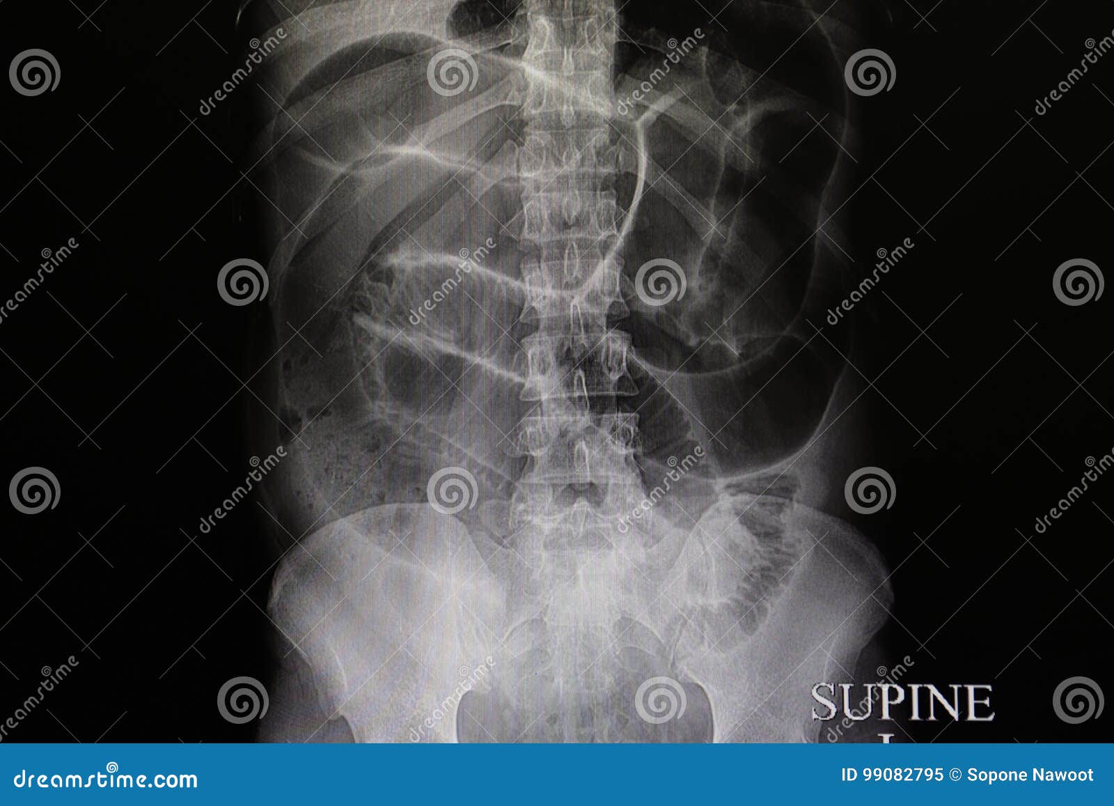 Obstruction intestinale image stock. Image du boucle - 99082795
