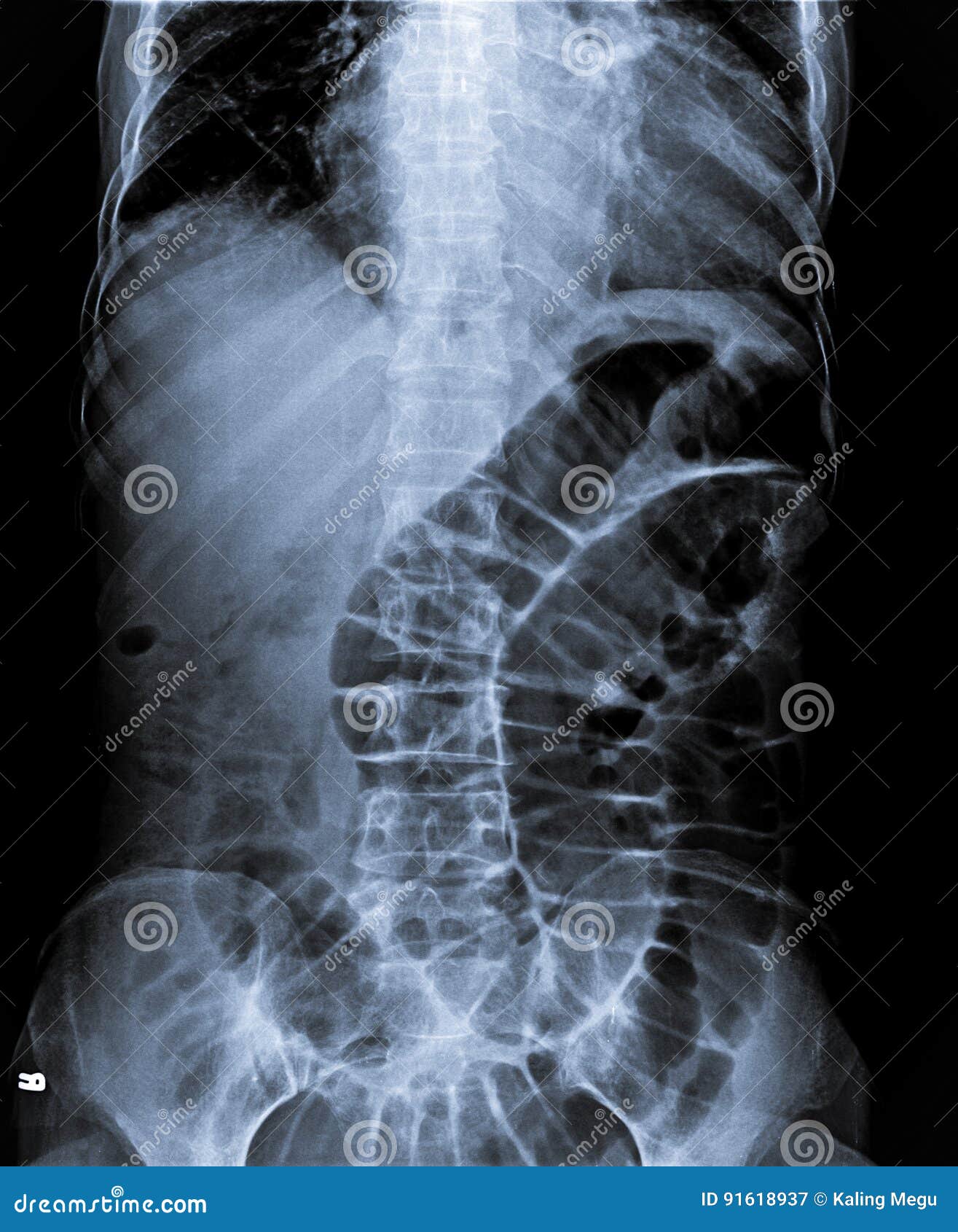 Obstruction Intestinale D'abdomen Humain Image stock - Image du rupture ...