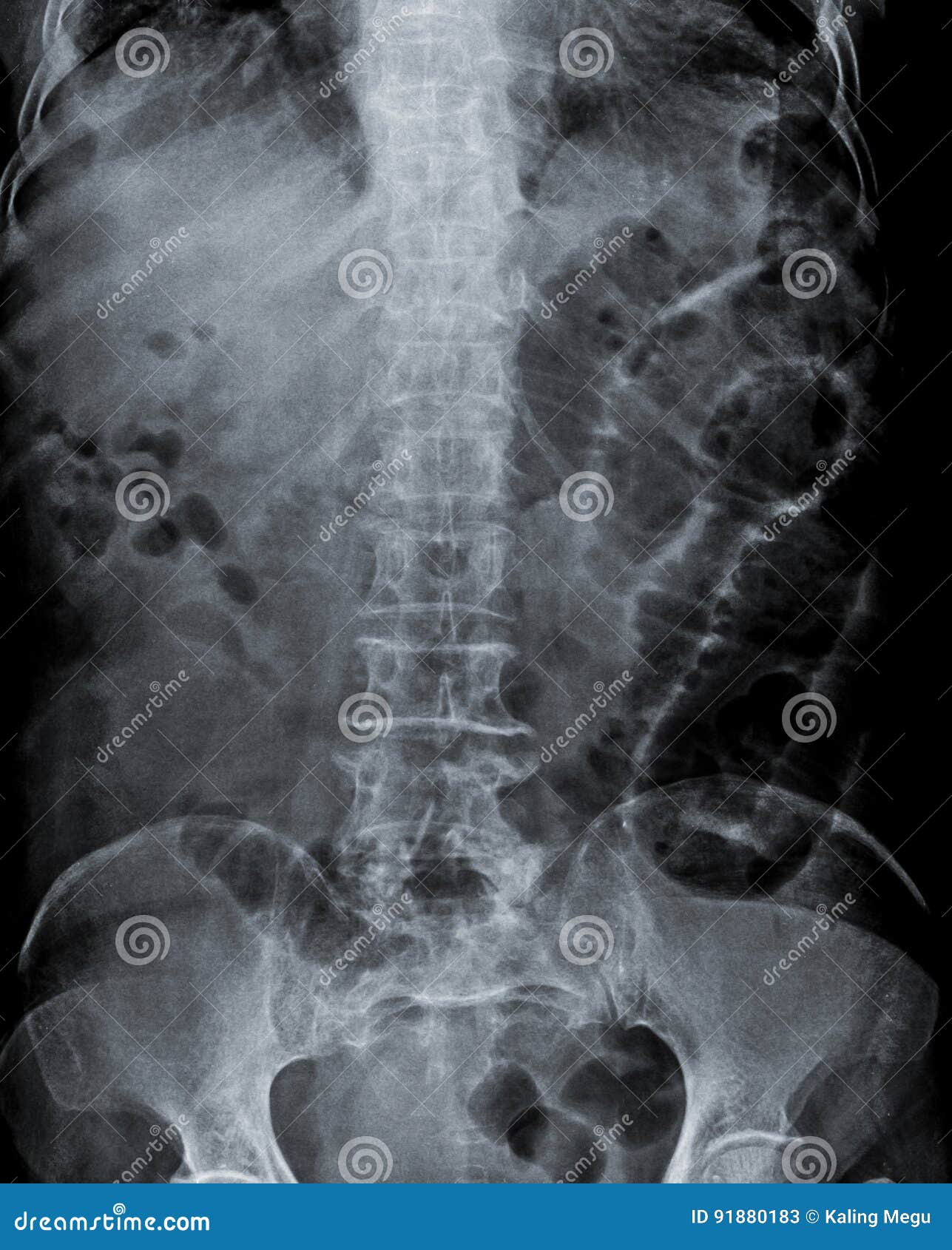 Obstruction Intestinale D'abdomen Humain Image stock - Image of ...