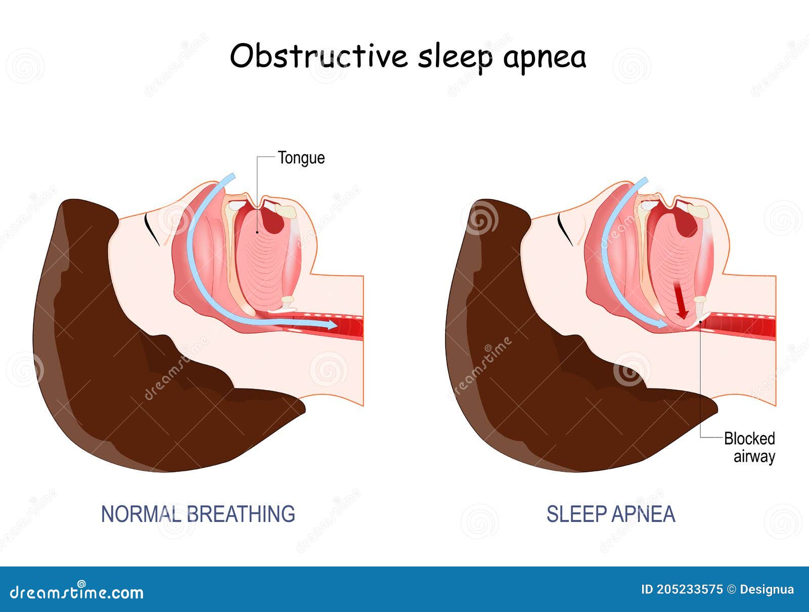 Obstructive Sleep Apnea Normal Breathing And Anatomy Of Snoring Stock