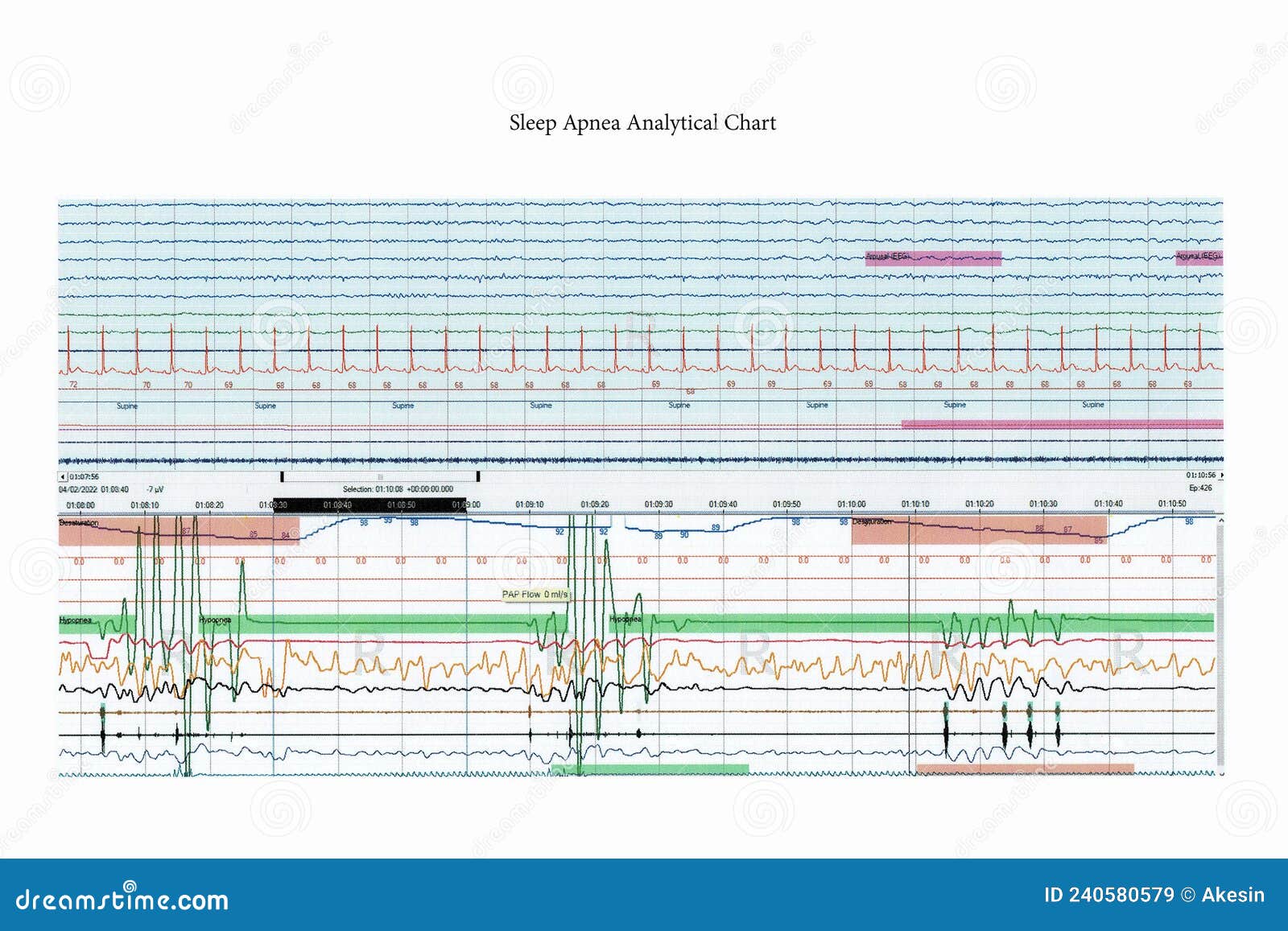 Obstructive Sleep Apnea Symptom Chart from Sleep Test for Doctor To ...