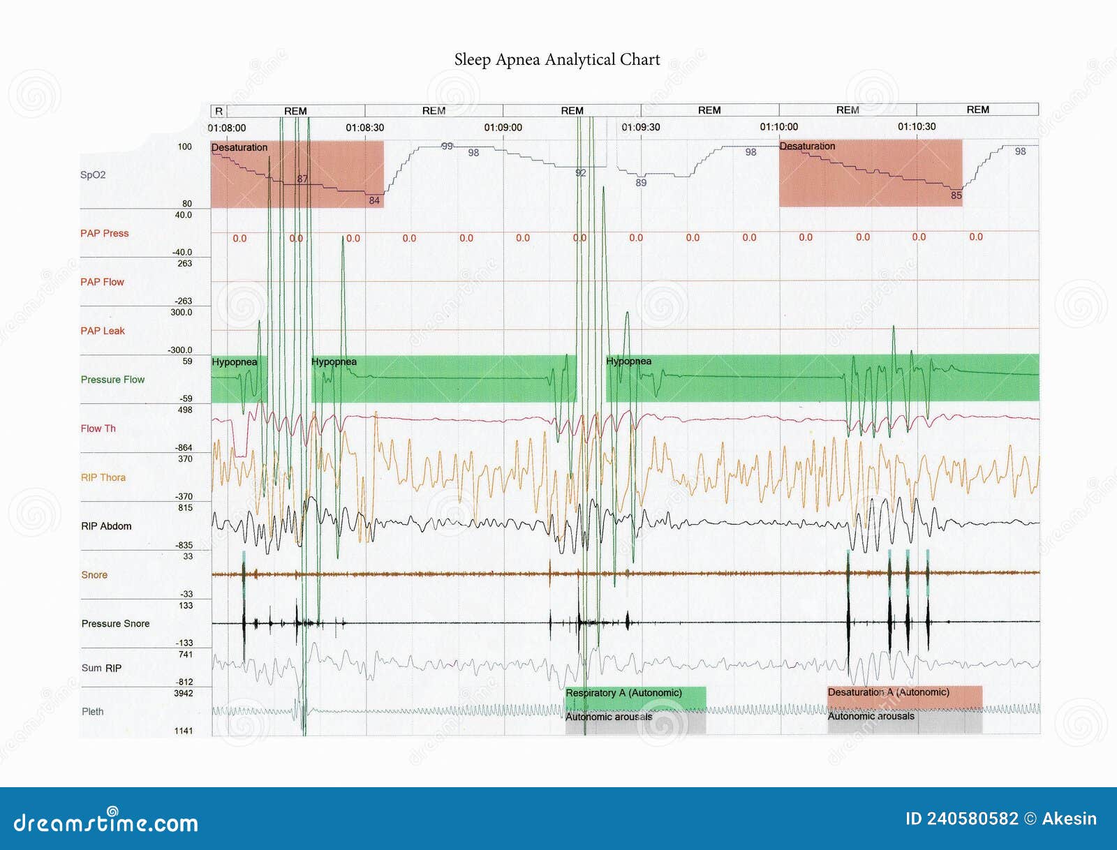 Obstructive Sleep Apnea Symptom Chart from Sleep Test for Doctor To ...