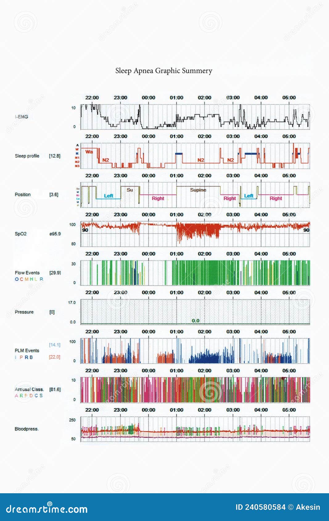 Obstructive Sleep Apnea Symptom Chart From Sleep Test For Doctor To Analytics Of Breathing