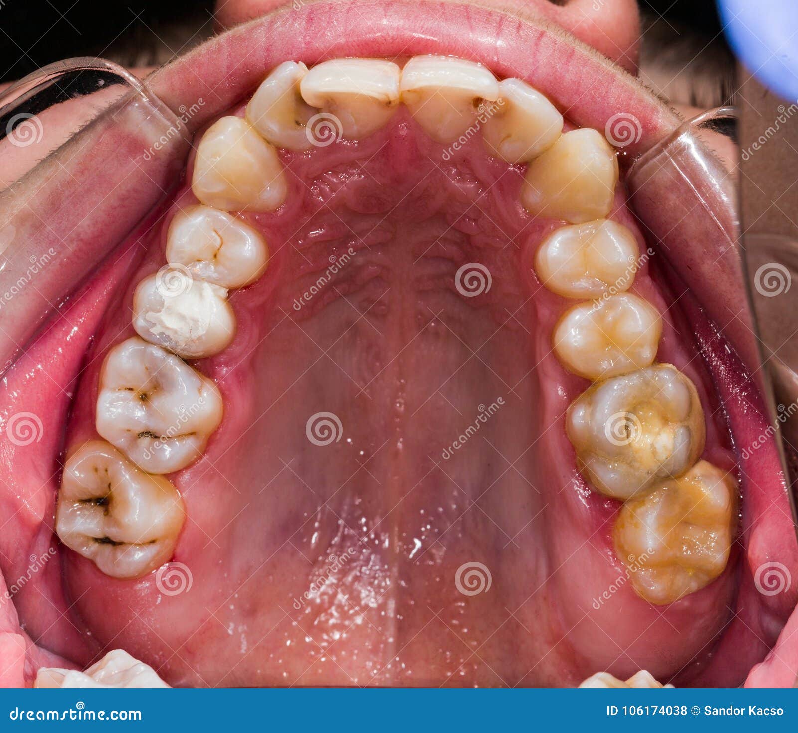 Decaying Teeth Stock Photos - Free & Royalty-Free Stock Photos from ...