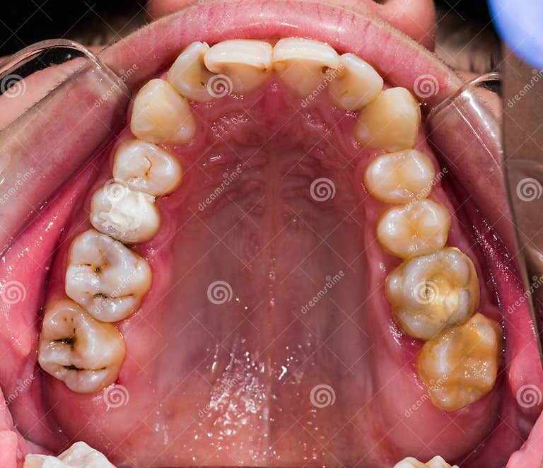 Human decaying teeth stock photo. Image of gingivitis - 106174038