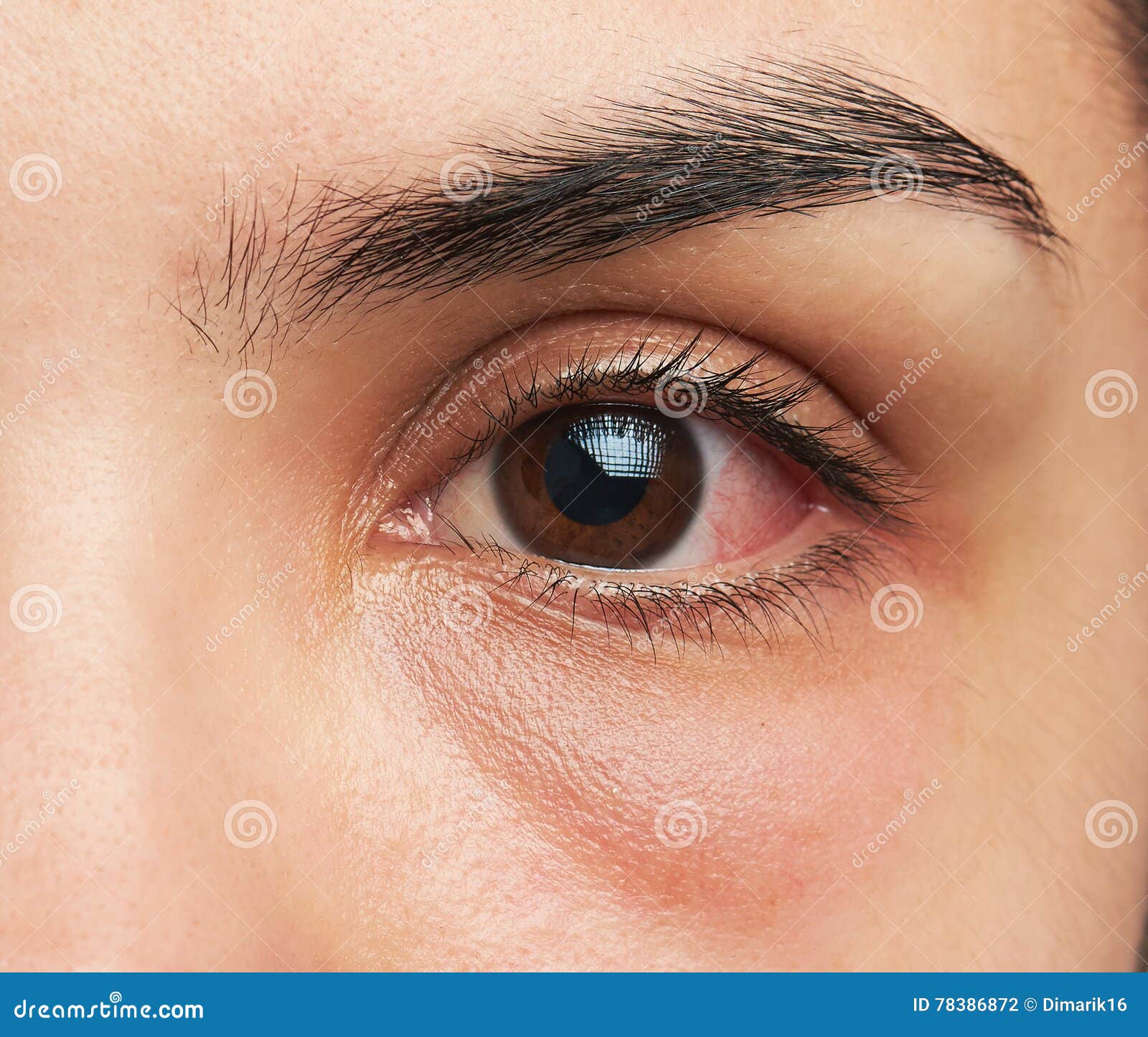 Oeil avec l'infection photo stock. Image du personne - 78386872