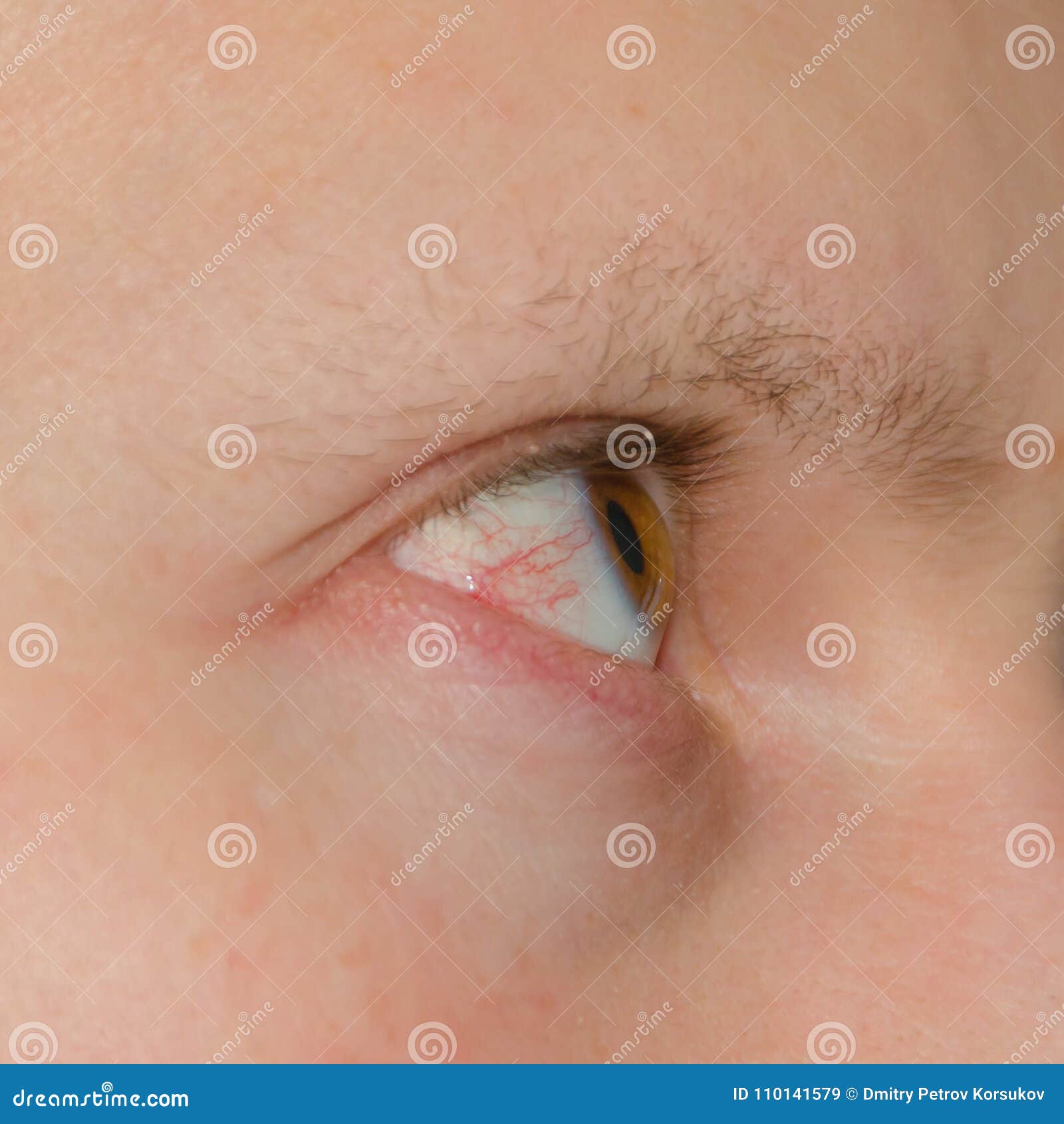 Oeil, Blessure, Vaisseaux Sanguins Image stock - Image of bloodshot ...
