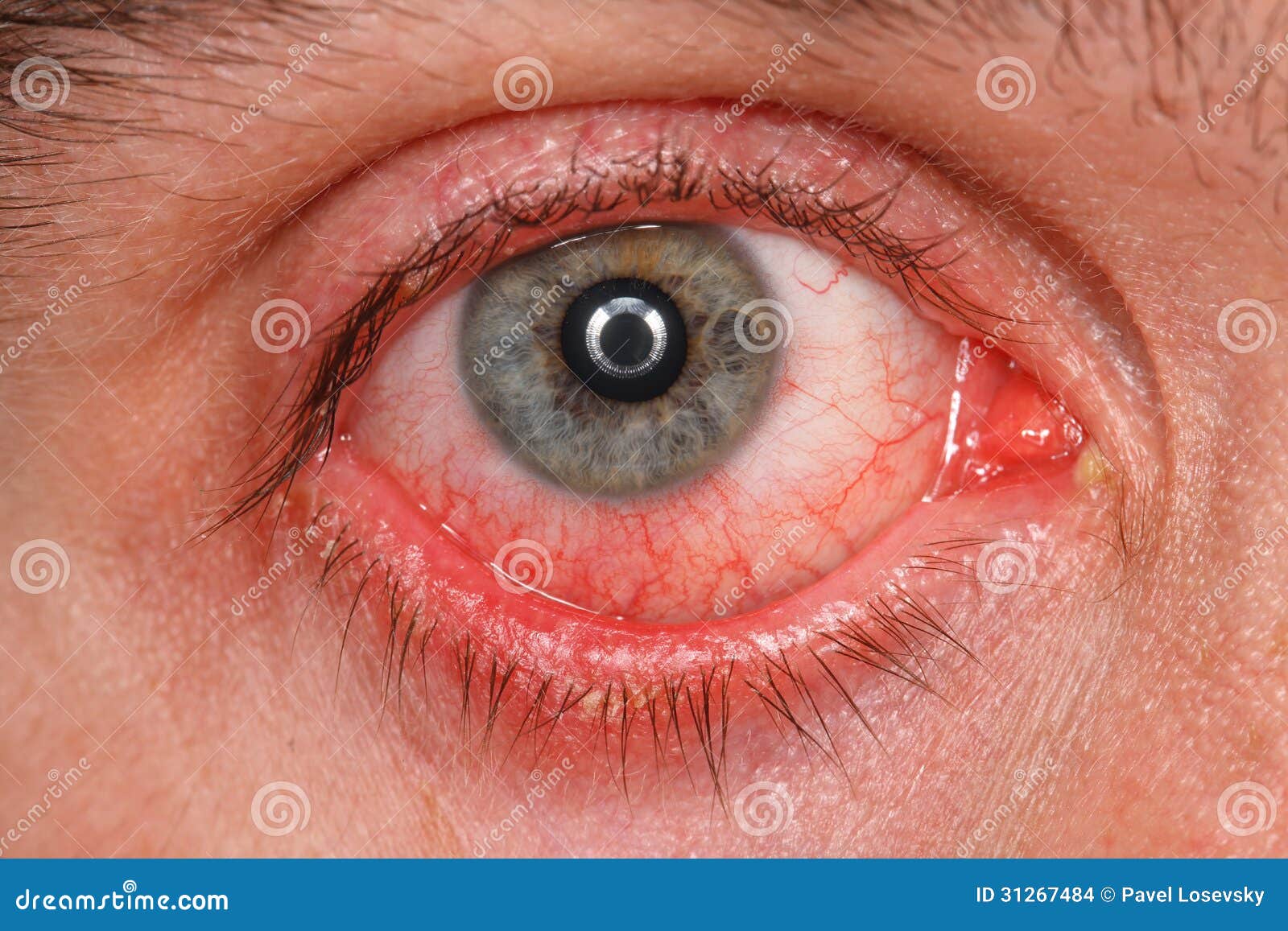 Oeil Chronique De Conjonctivite Photo stock - Image du sang ...
