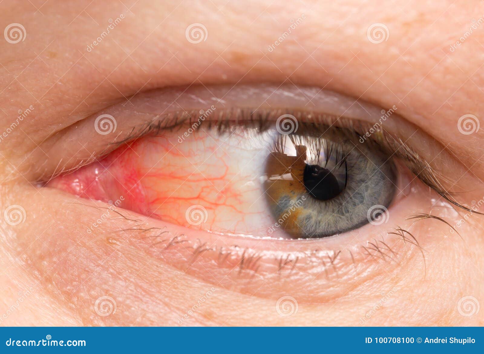 Oeil Chronique De Conjonctivite Avec Un Iris Et Un Plan Rapproché ...