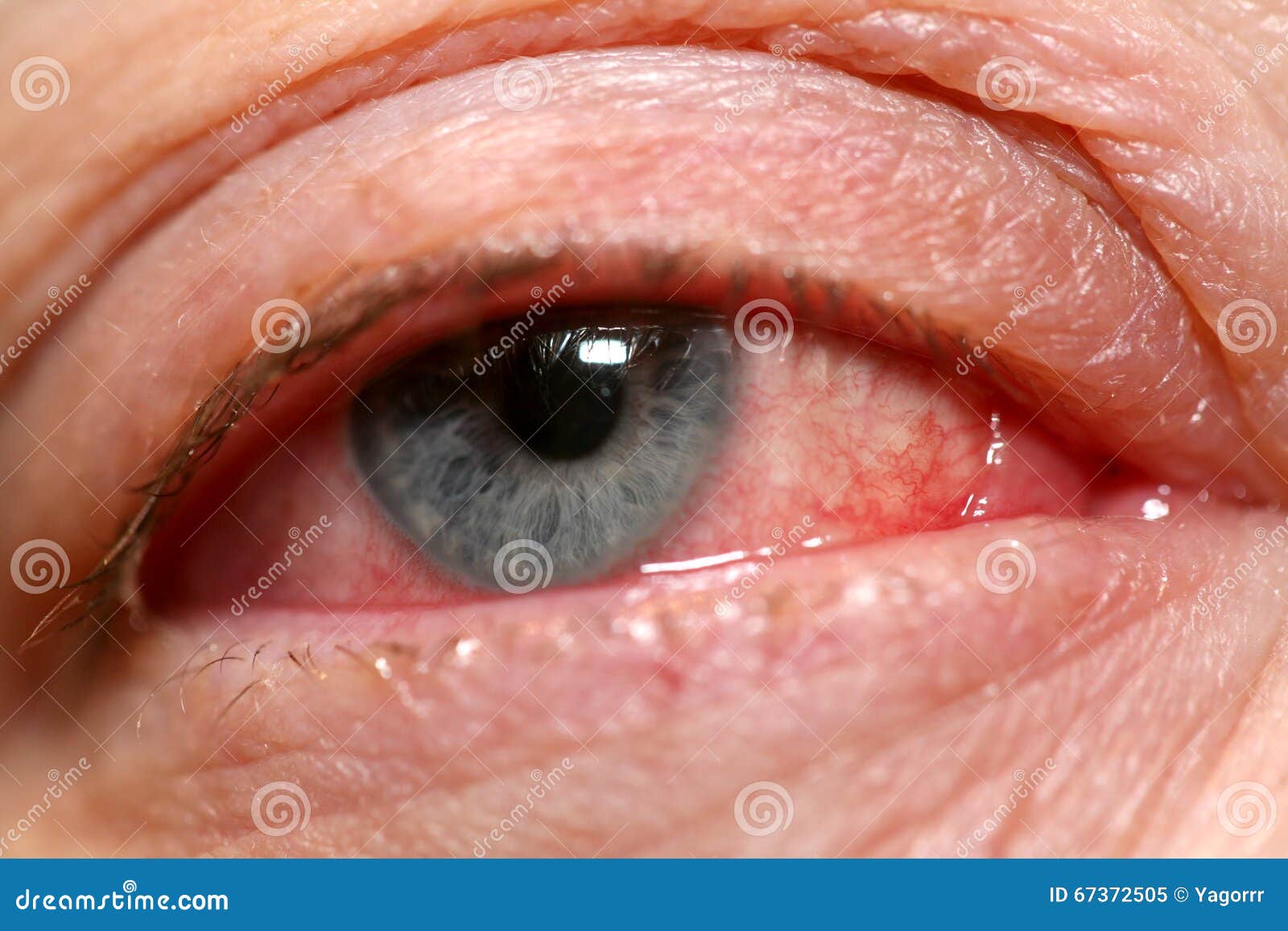 Oeil Humain Avec La Conjonctivite Image stock - Image du oeil ...