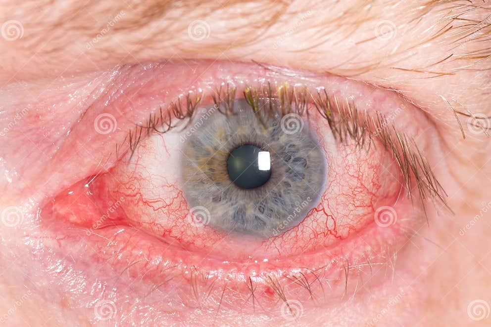 Oeil humain rouge photo stock. Image du visibilité, allergènes - 26965490