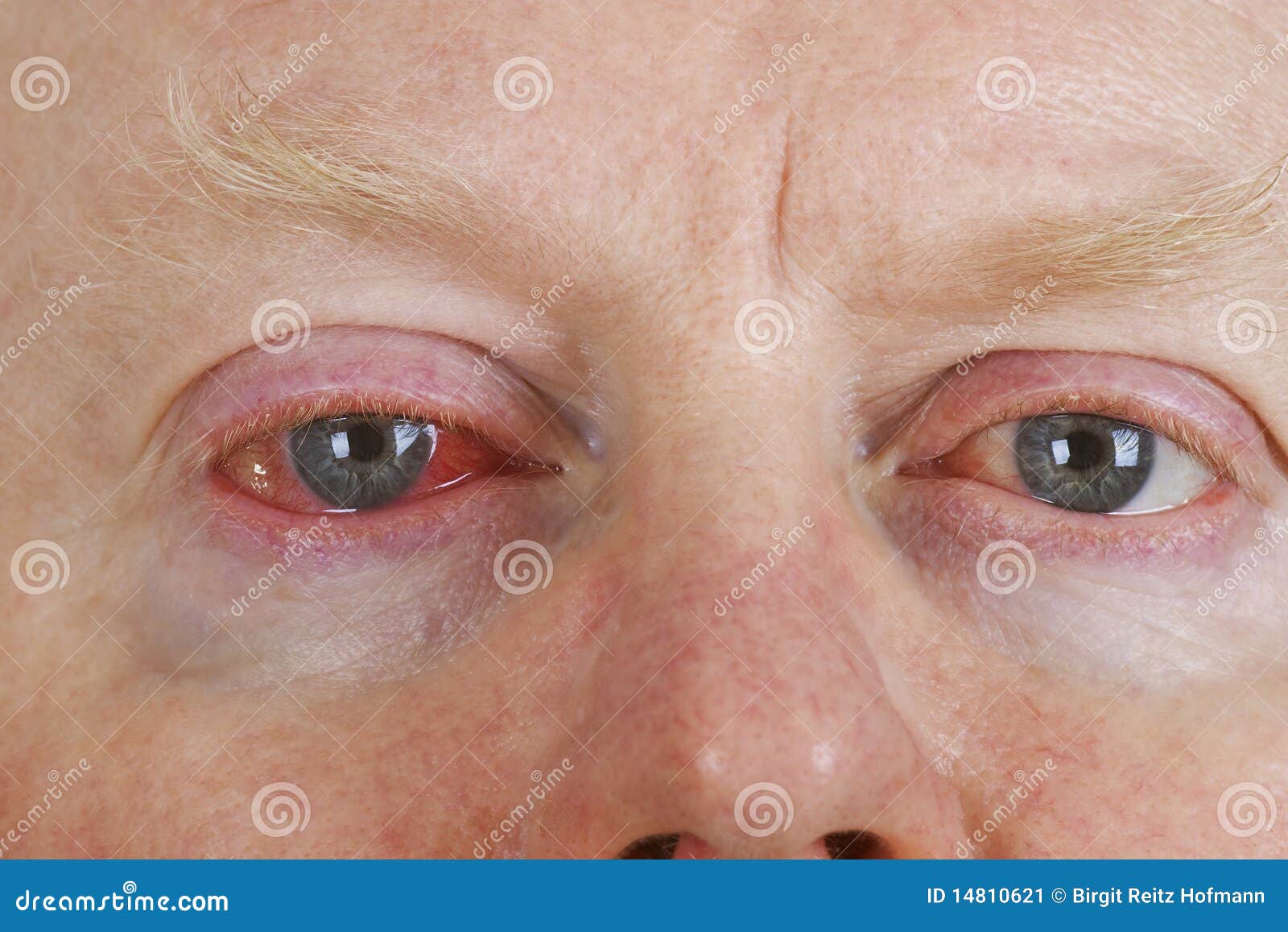 Oeil injecté de sang image stock. Image du rides, mûr - 14810621