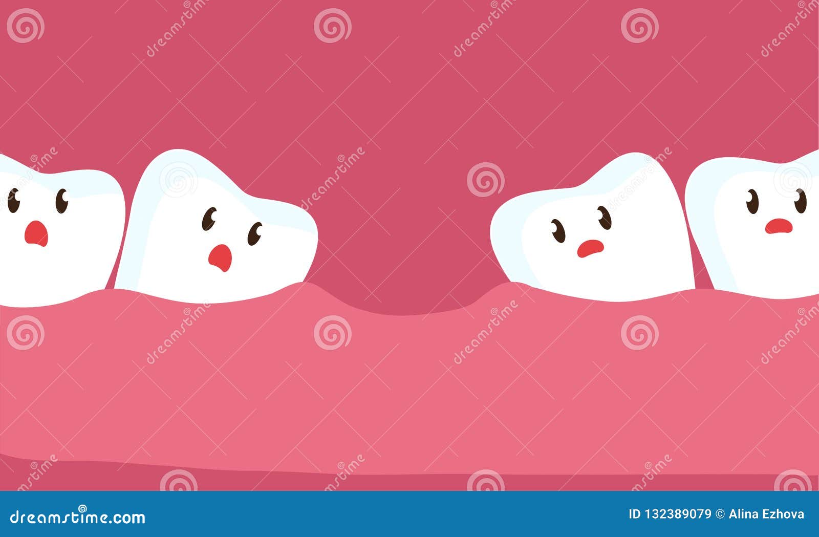Offset Teeth Due To Tooth Extraction. Illustration. Stock Vector ...
