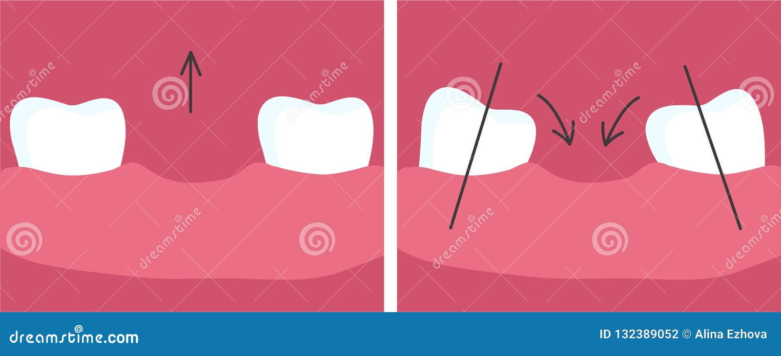 Offset Teeth Due To Tooth Extraction. Illustration. Stock Vector ...